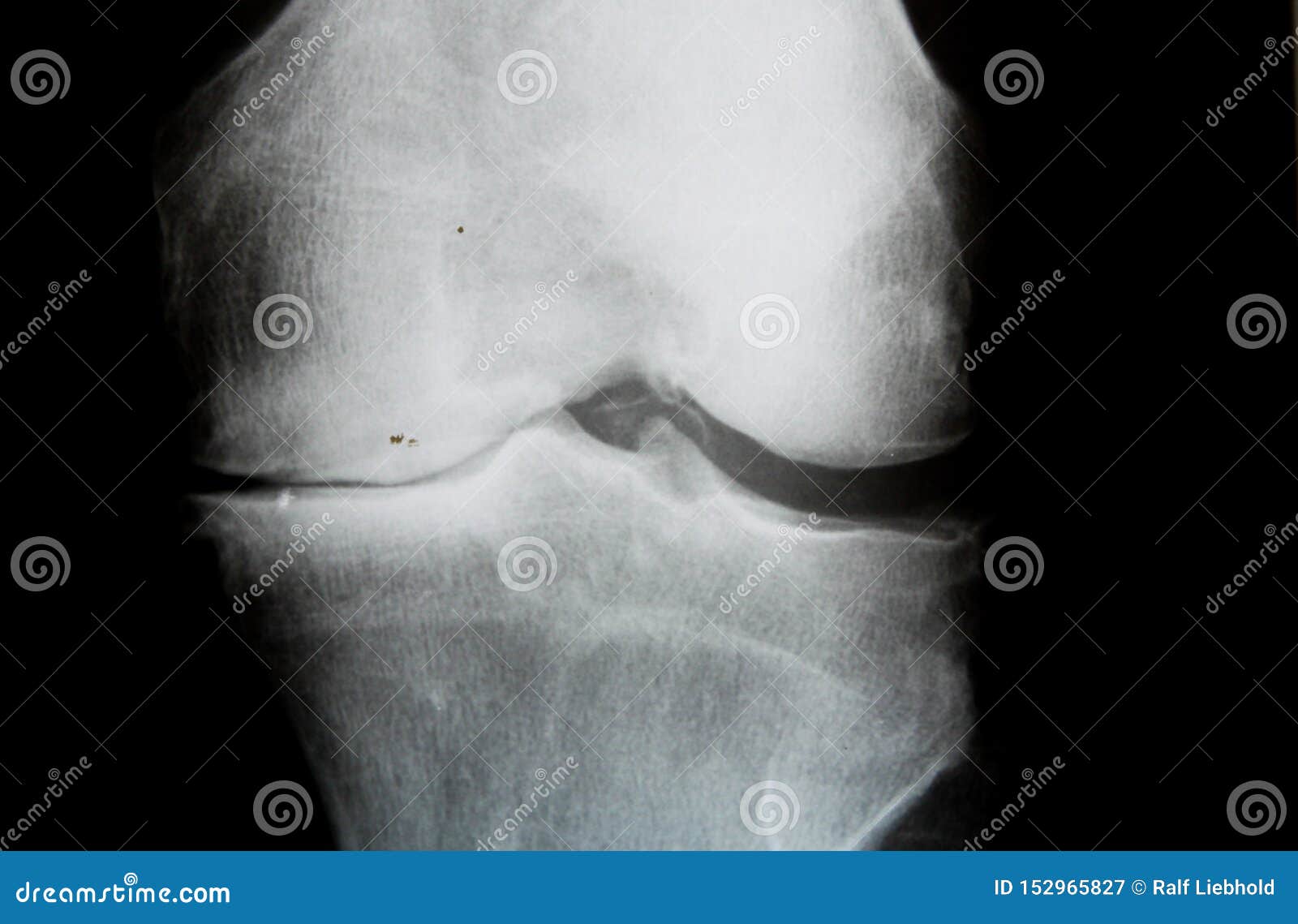 X-Ray Image of Knee Joint with Advanced Arthrosis Gonarthrose Stock ...