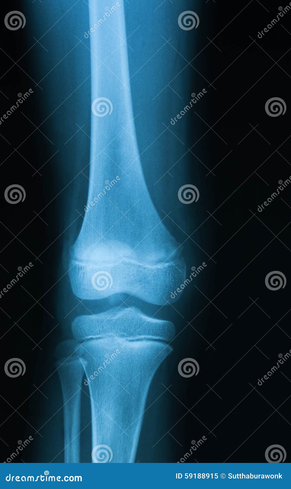 X-ray image of knee joint. stock image. Image of joint - 59188915
