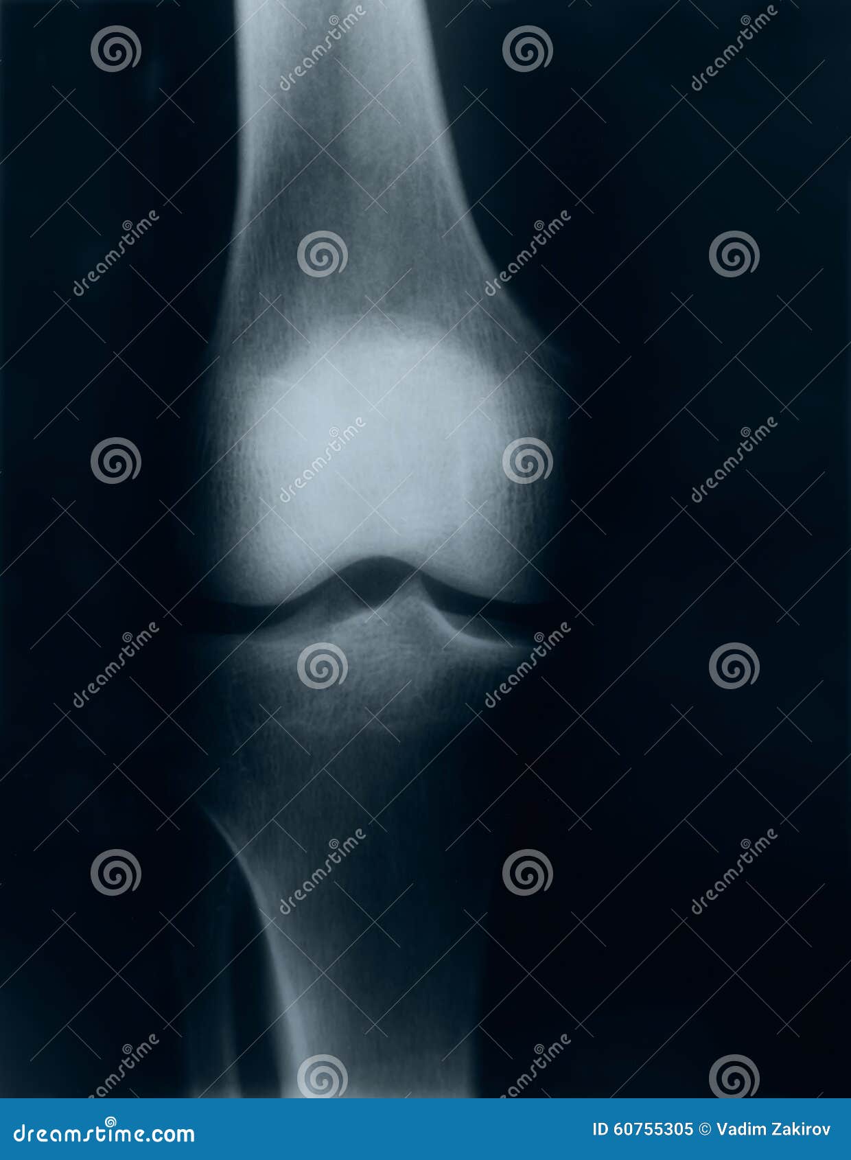 X Ray Image Of Knee. X-ray Of The Knee Joint Royalty-Free Stock ...