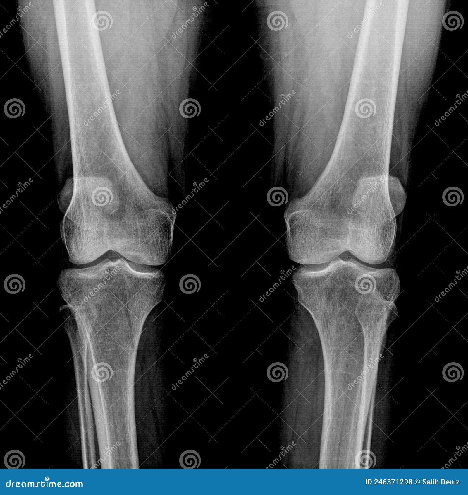 X-ray image of knee stock photo. Image of skeleton, medical - 246371298