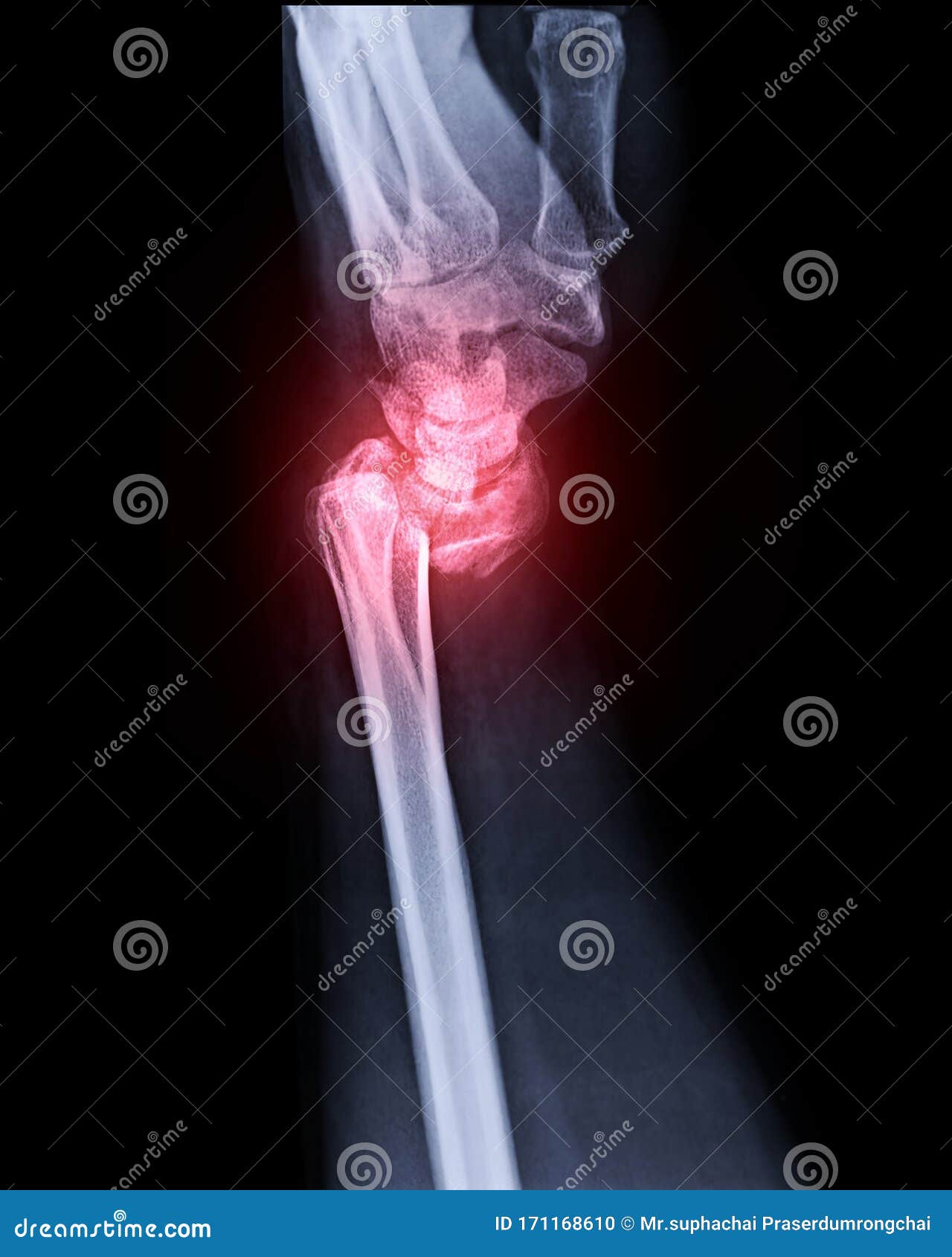 X-ray Image of Left Wrist Joint AP and Lateral View Stock Photo - Image ...