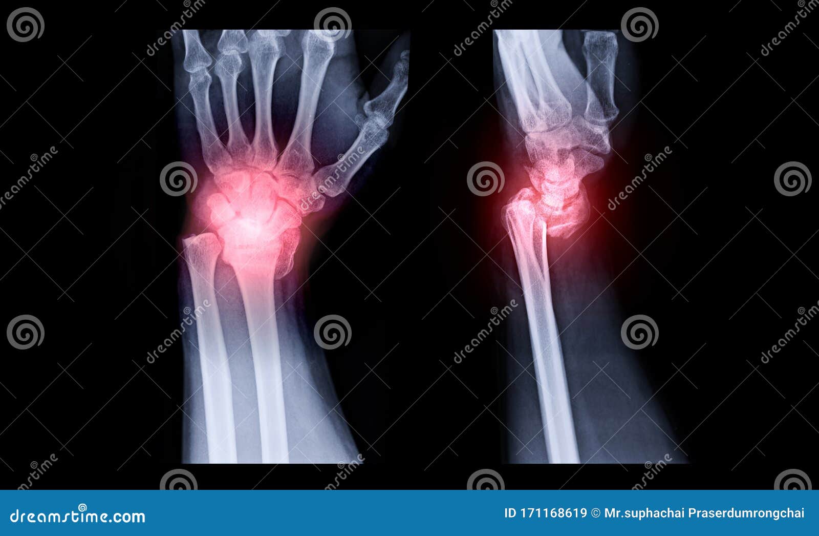 X-ray Image of Left Wrist Joint AP and Lateral View Stock Image - Image ...