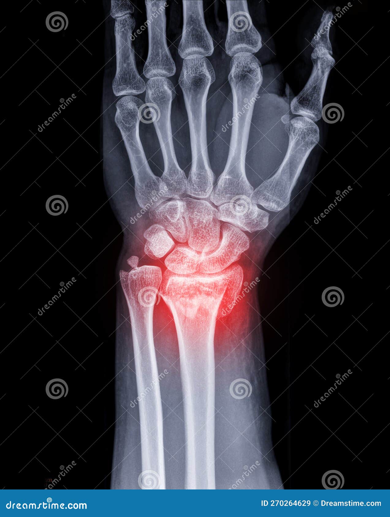Dislocated Wrist X Ray