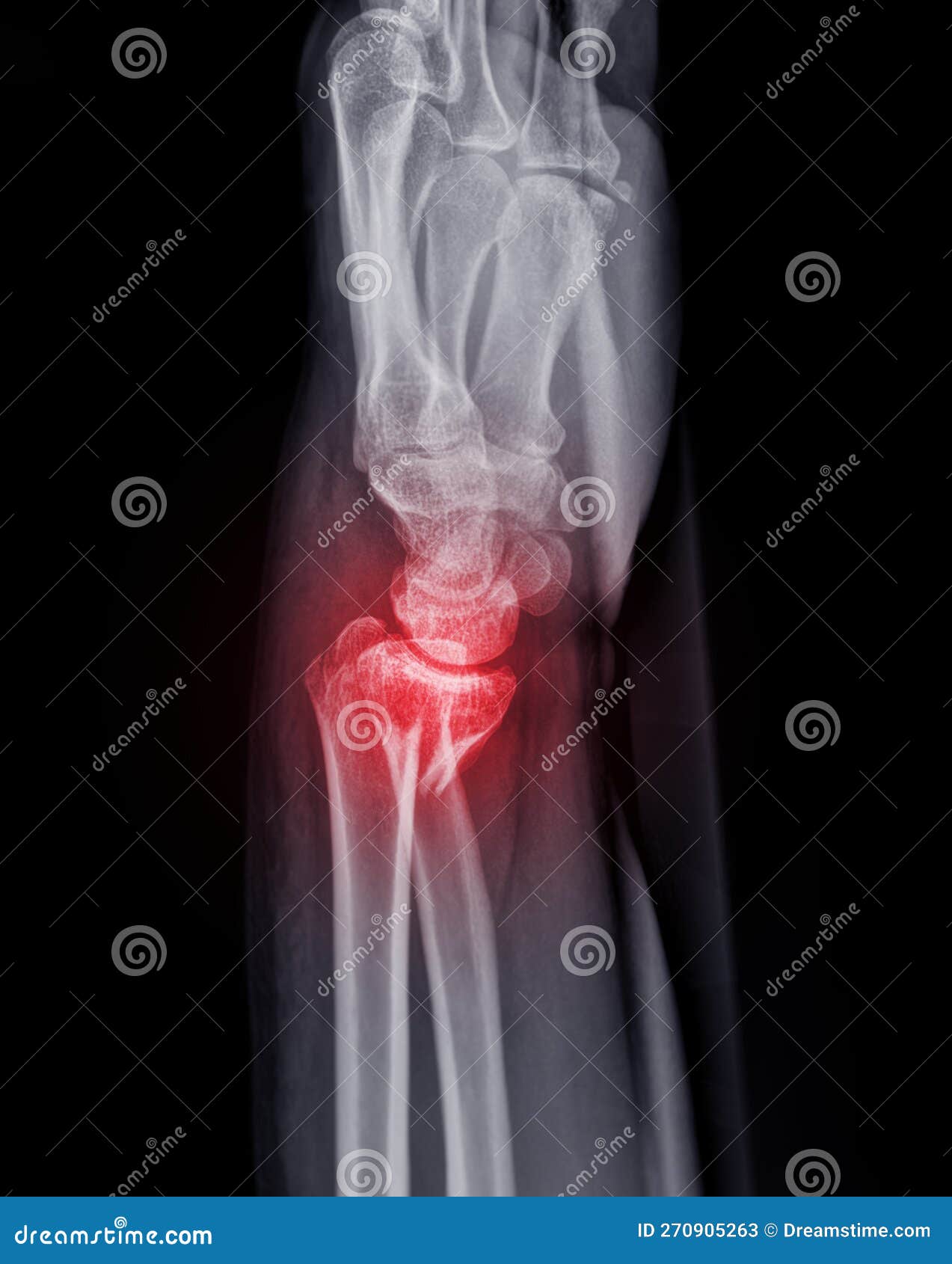 Left Lateral Wrist X Ray