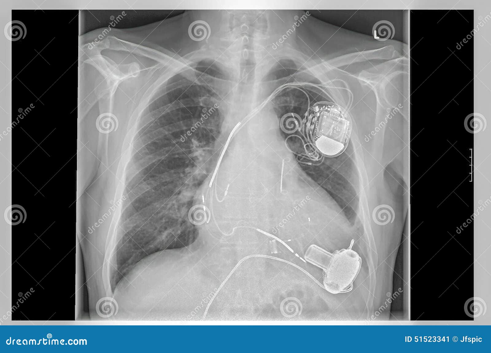 Ai Can Improve Xray Identification Of Pacemakers In