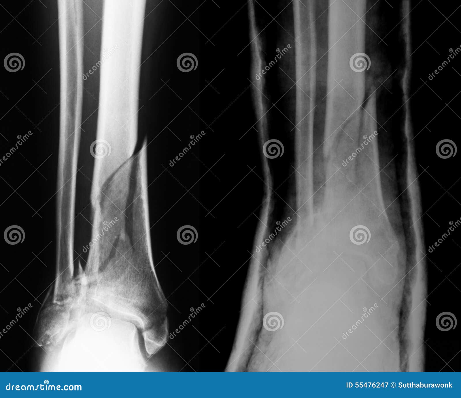 X-ray image of lower leg stock image. Image of clinical - 55476247