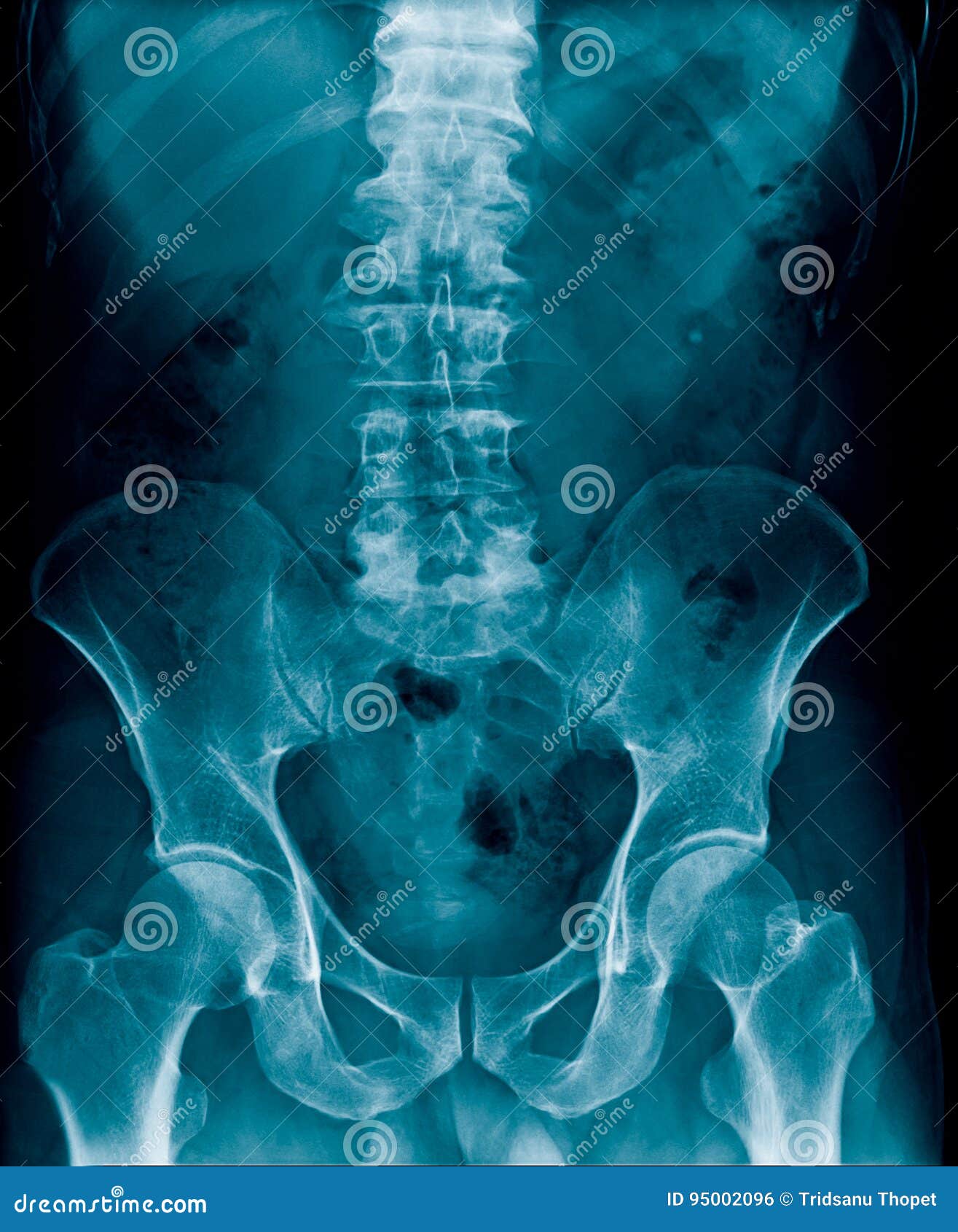 X-ray image lumbar bone stock photo. Image of adult, human - 95002096