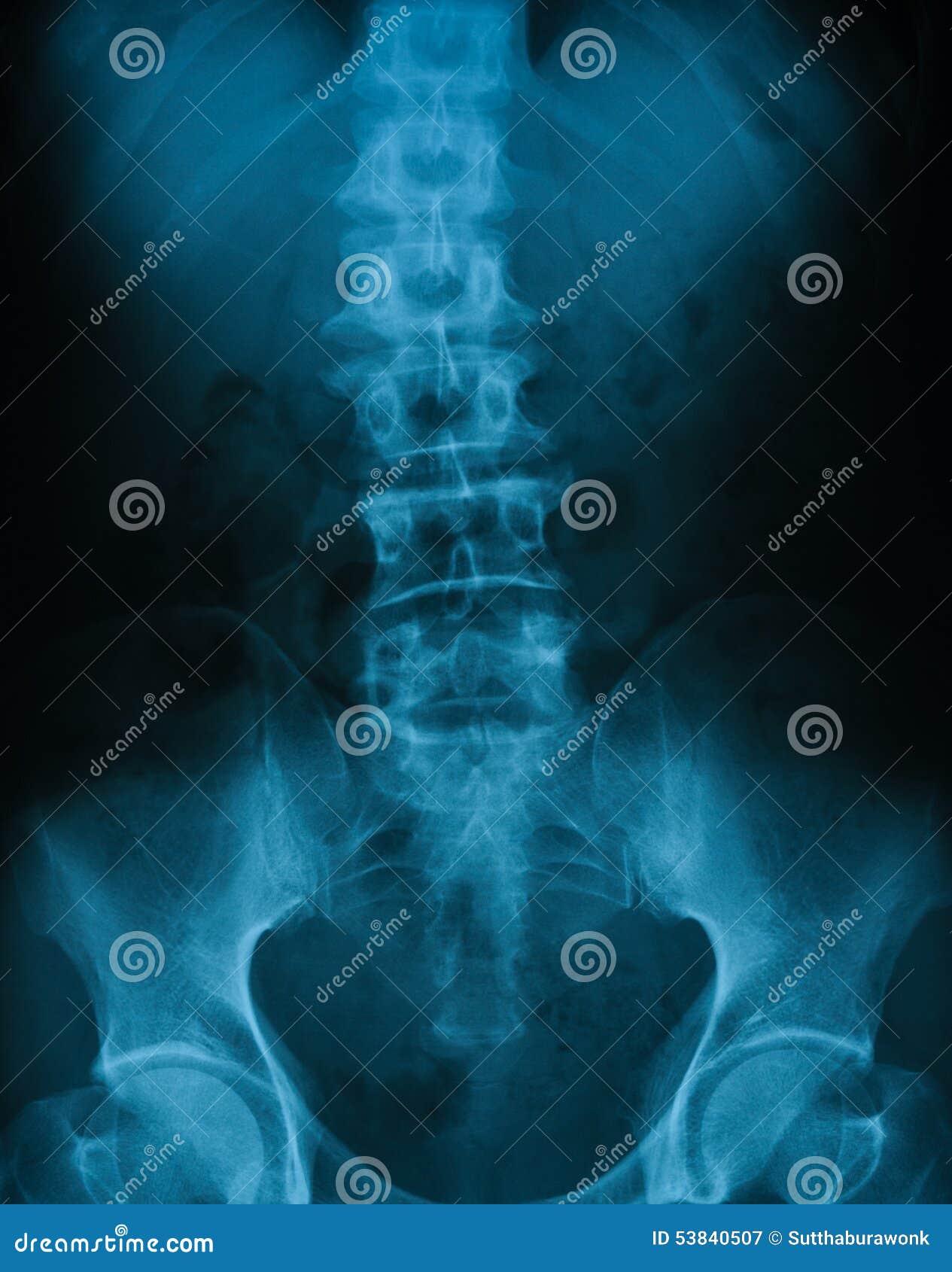 X-ray Image of Lumbar Spine, AP View. Stock Image - Image of diagnosis ...