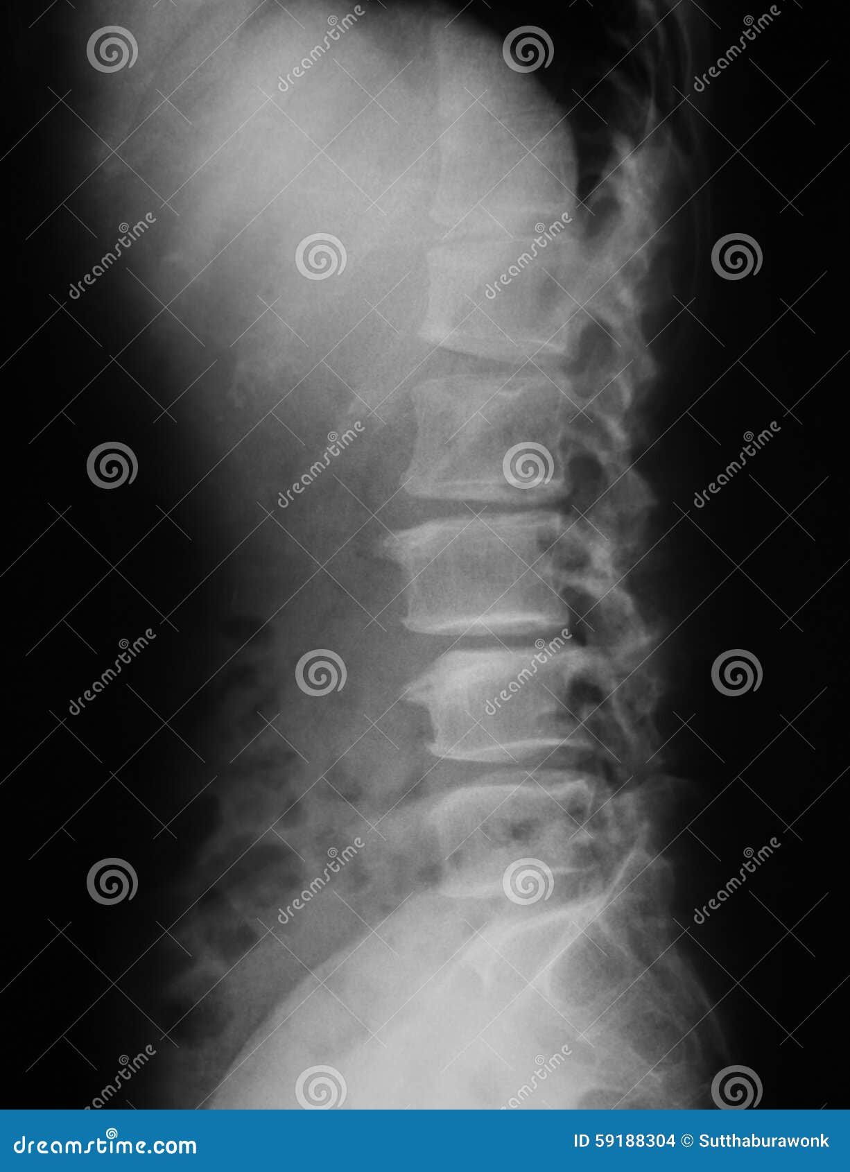 X-ray Image of Lumbar Spine, AP View. Stock Photo - Image of exam ...