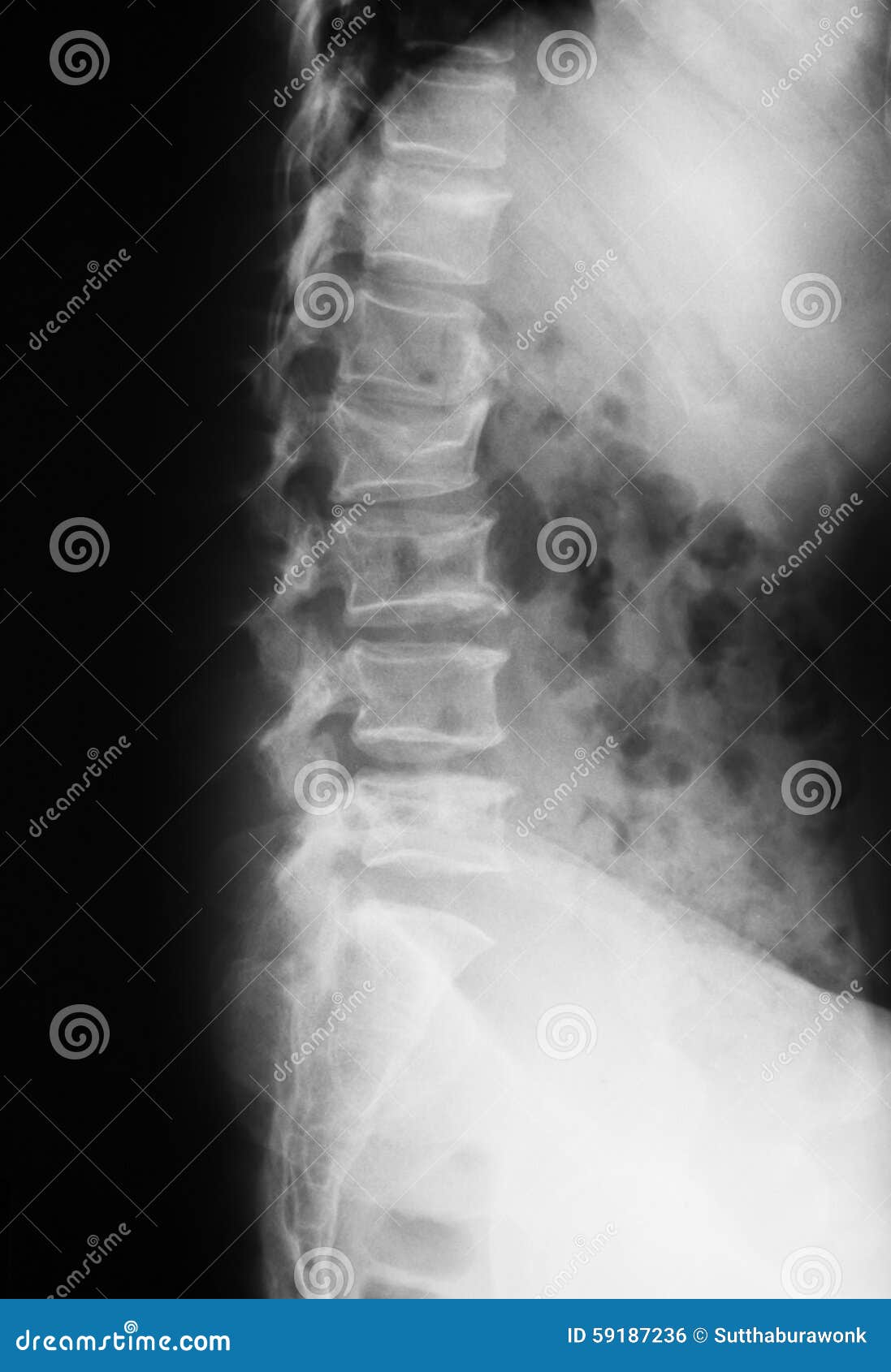 Film Ray Spine Lateral Views Showing Compression Fracture, 51% OFF