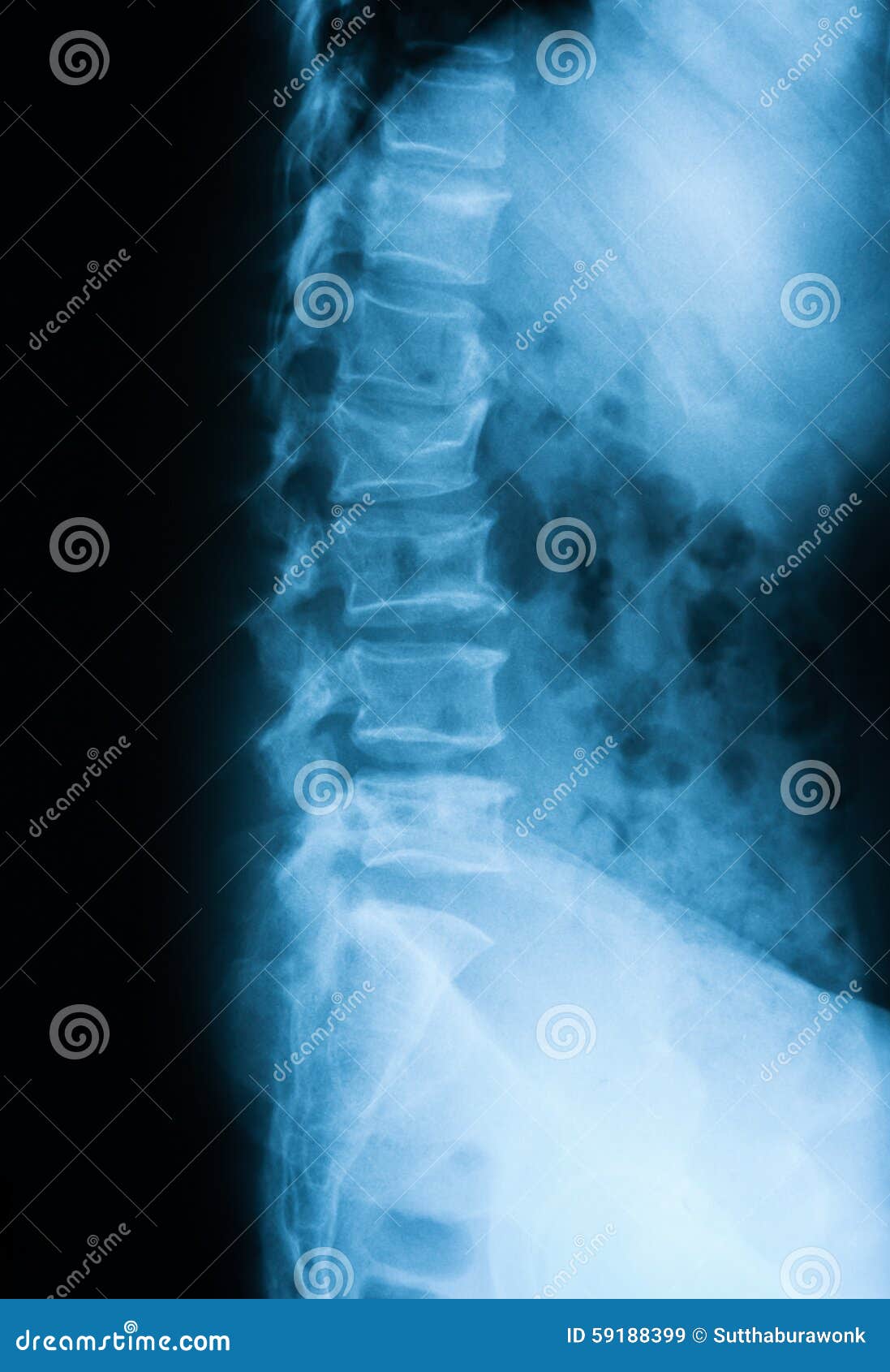 X-ray Image of Lumbar Spine(L-spine), Lateral View. Showing Com Stock ...