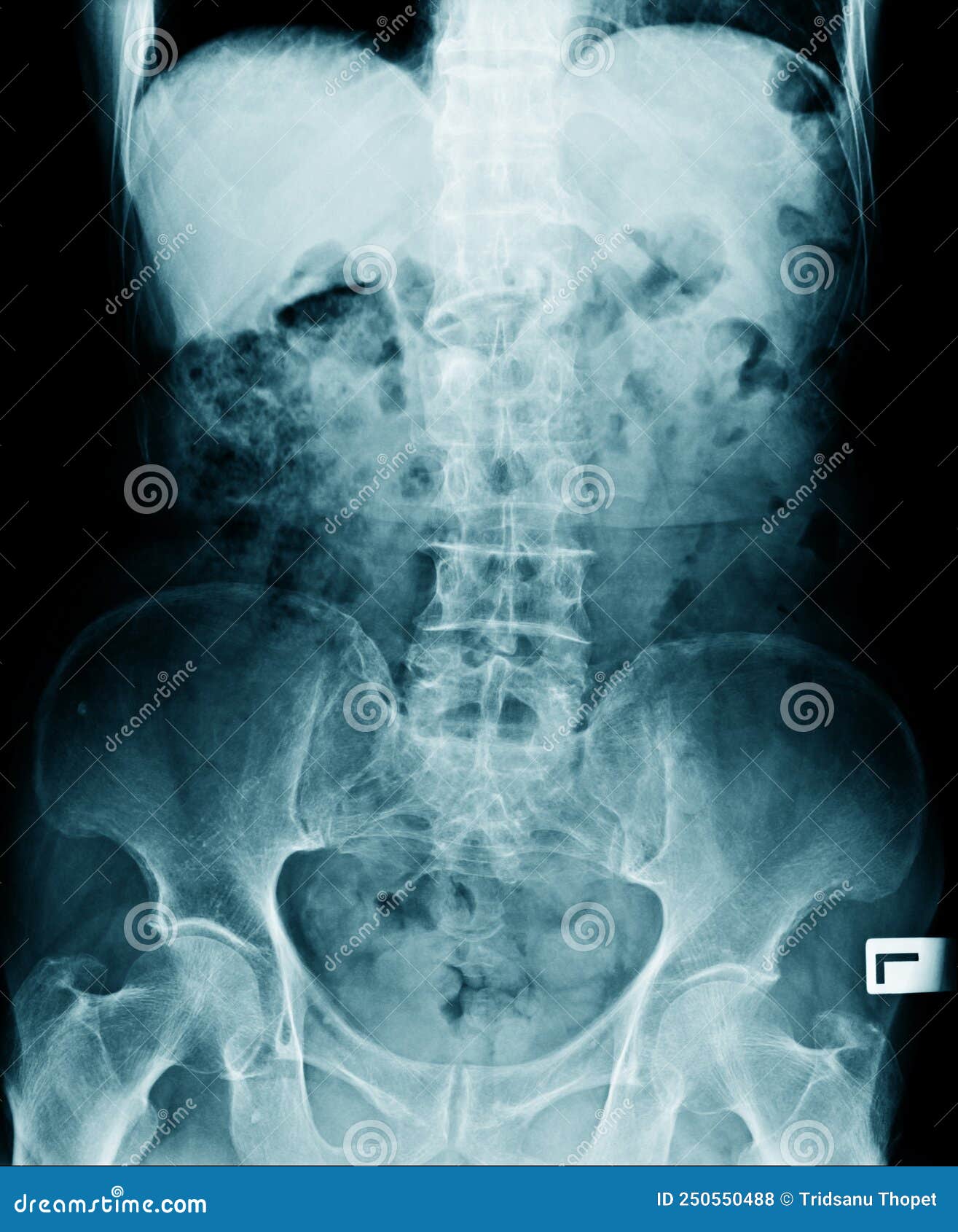 X-ray Image of Lumbo Sacral Stock Photo - Image of health, pelvis ...