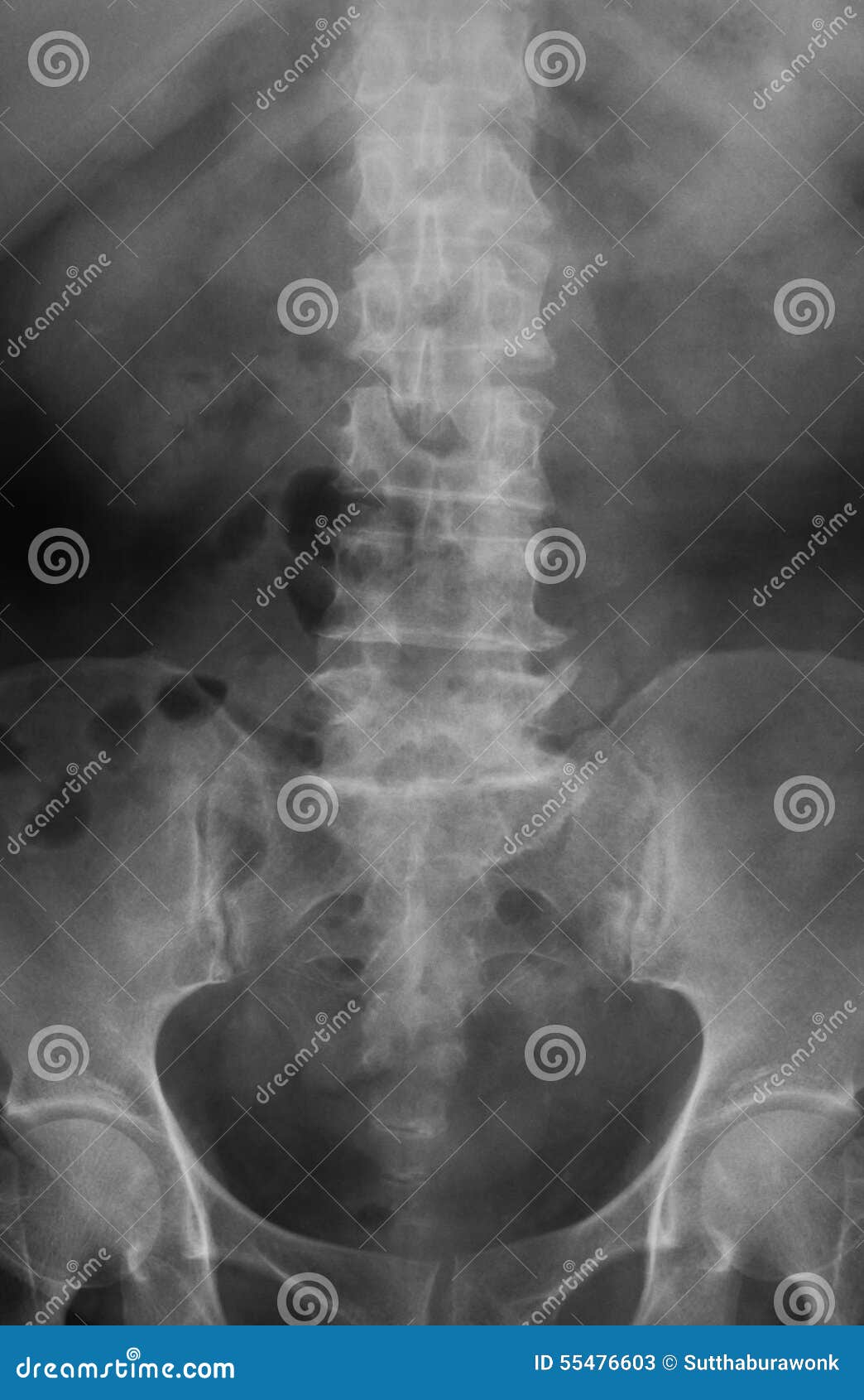 .X-ray Image of Lumbosacral (L-S) Spine. Stock Image - Image of ...