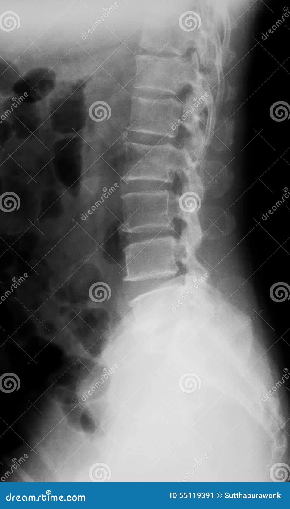 MRI Scan Of Lumbosacral LS Spine, Coronal View, Case Of Lumbar ...