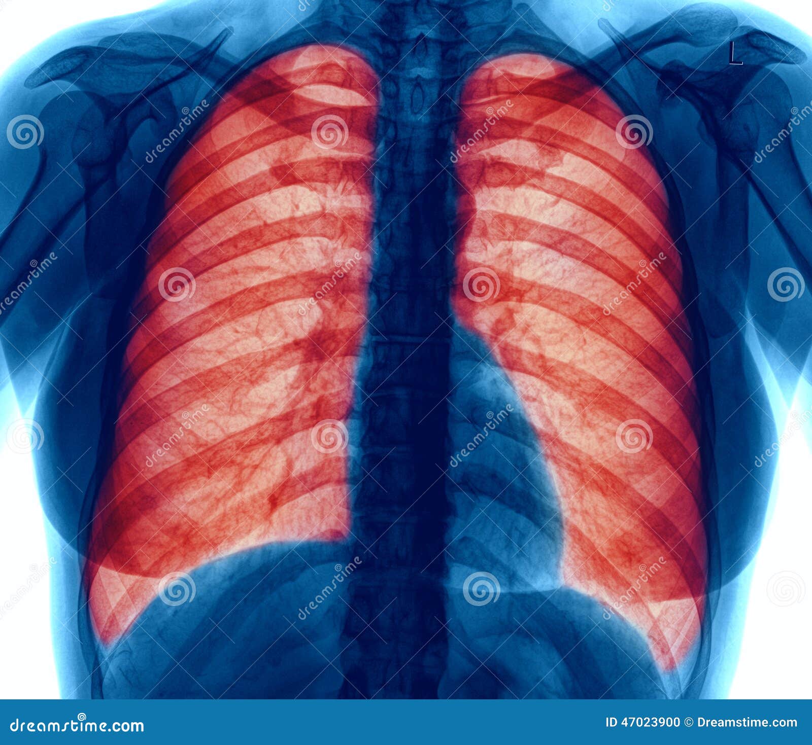 X-Ray Image of Lung Infection. Stock Illustration - Illustration of ...