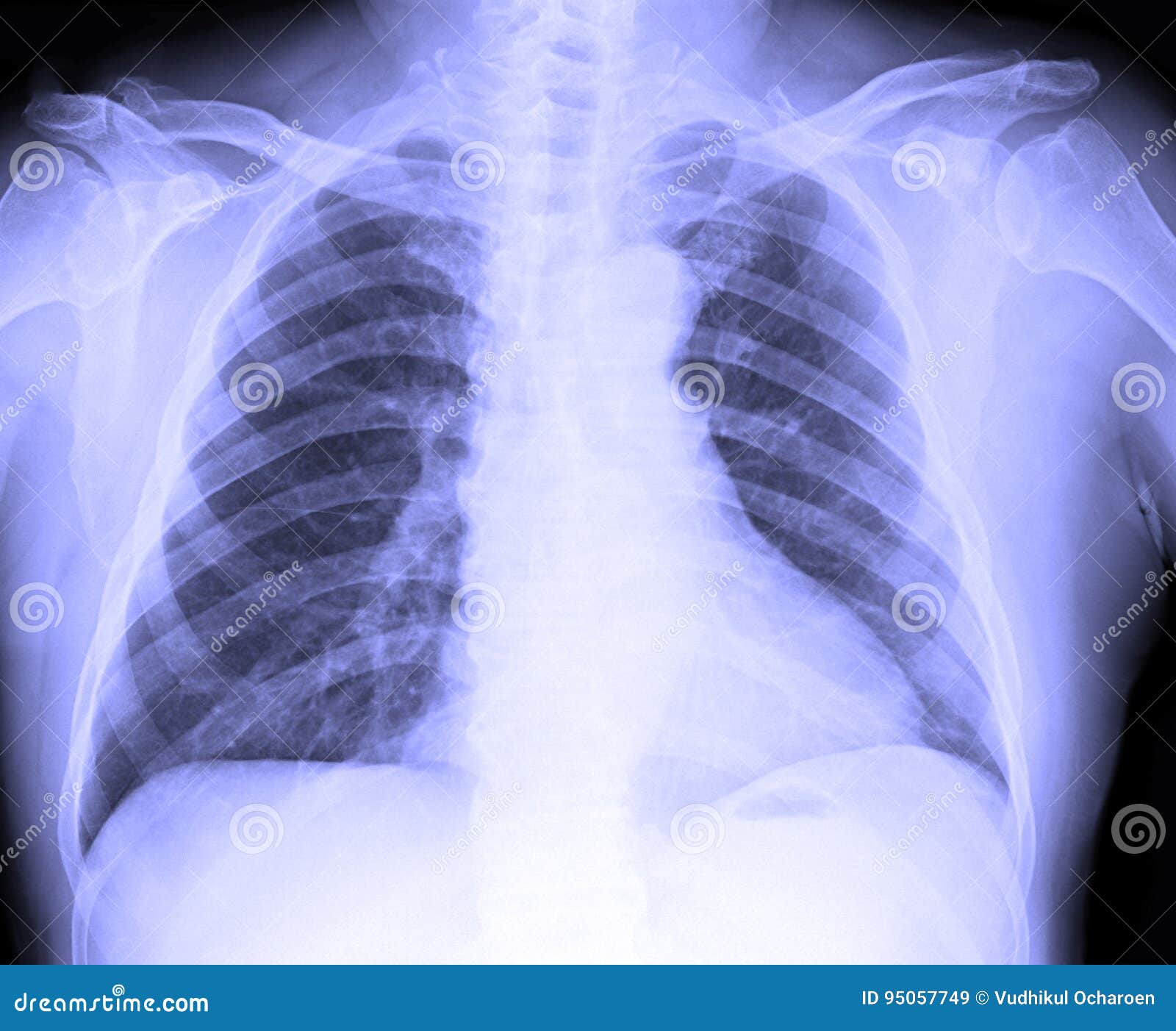 X-Ray Image of Male Human Chest Stock Image - Image of hospital, sheet ...