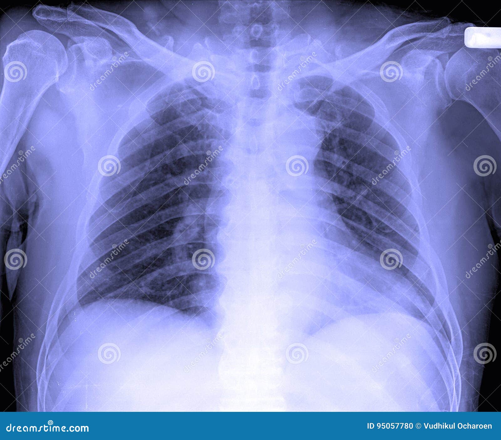 X-Ray Image of Male Human Chest Stock Photo - Image of radiology, rays ...