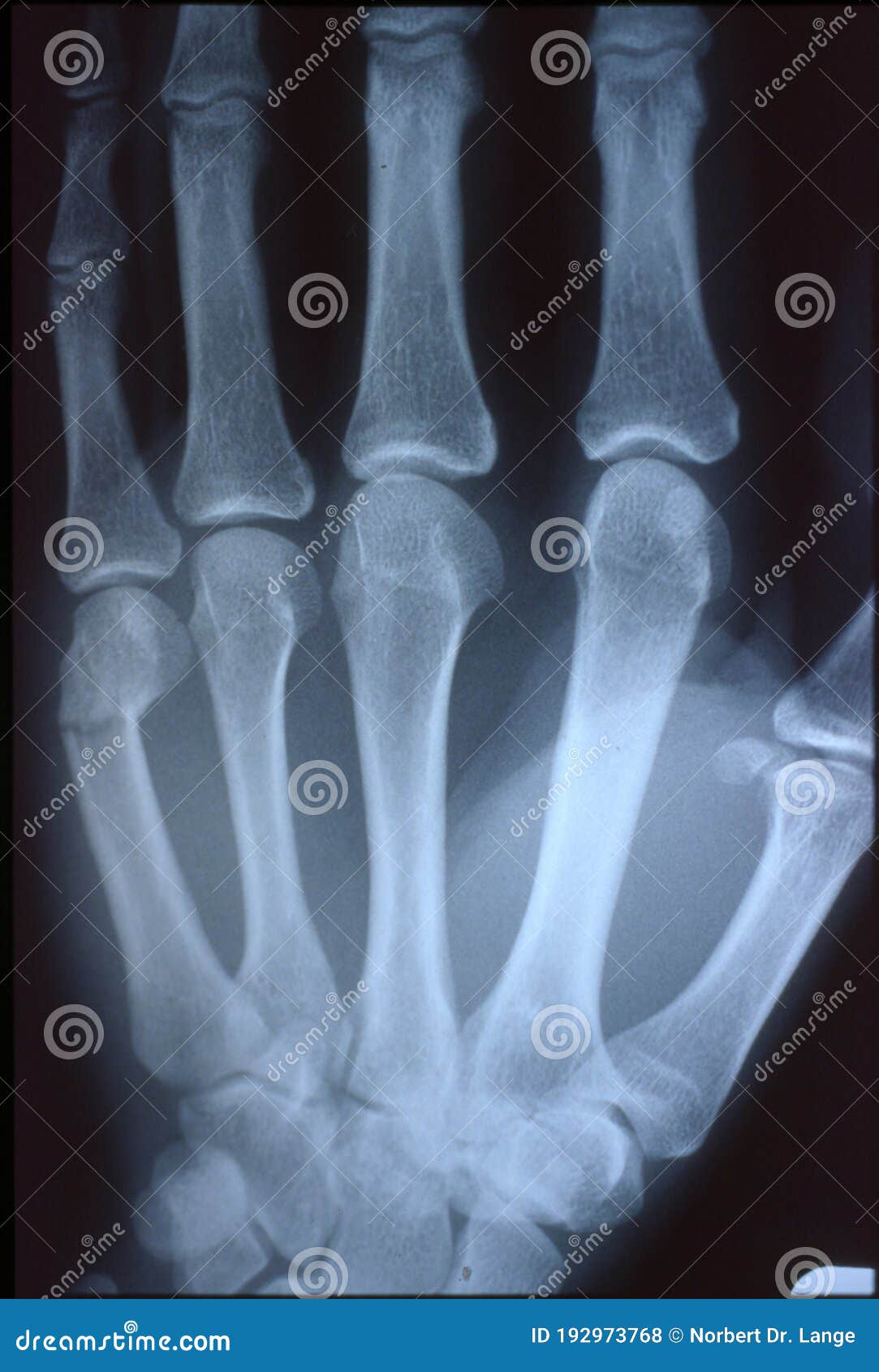 X-ray Image, Man, Hand with Bones Stock Photo - Image of hand, joint ...