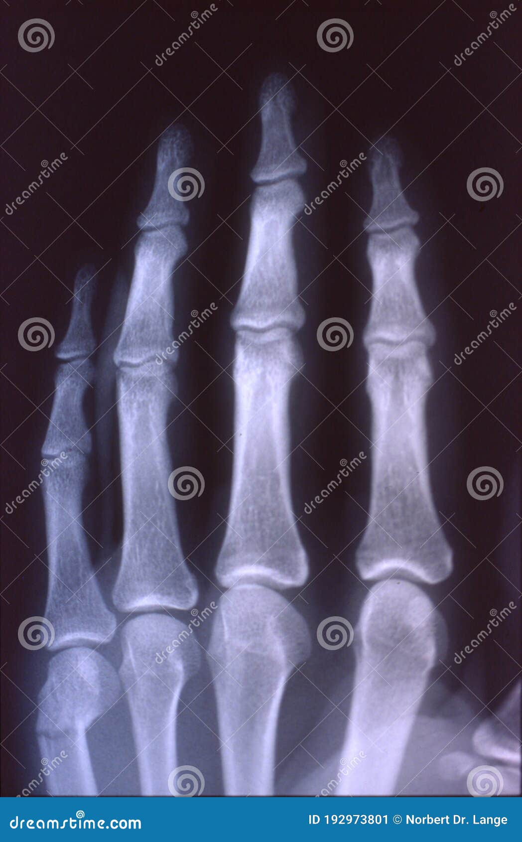 X-ray Image, Man, Hand with Bones Stock Image - Image of radiation ...