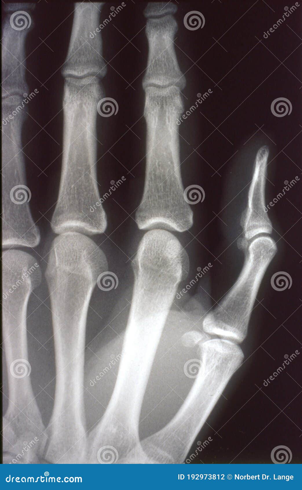 X-ray Image, Man, Hand with Bones Stock Photo - Image of hospital, hand ...