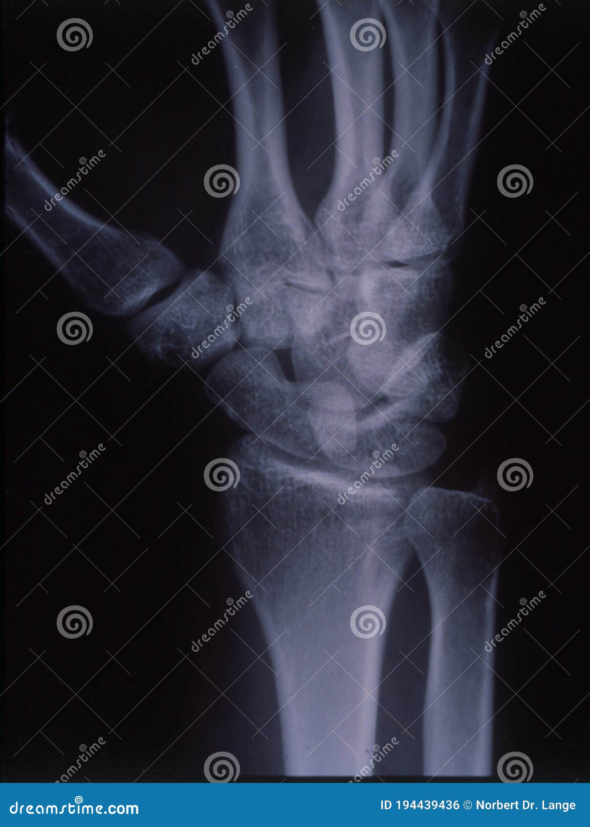 X-ray Image, Man, Hand with Bones Stock Photo - Image of research ...