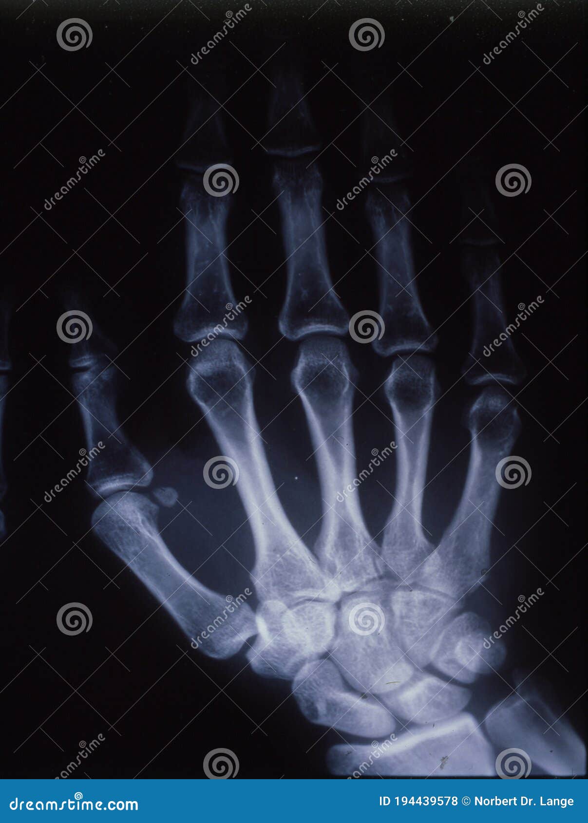 X-ray Image, Man, Hand with Bones Stock Photo - Image of examination ...