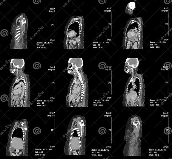 X Ray Image Mri Scan Stock Image Image Of Cancer Scan 297003303