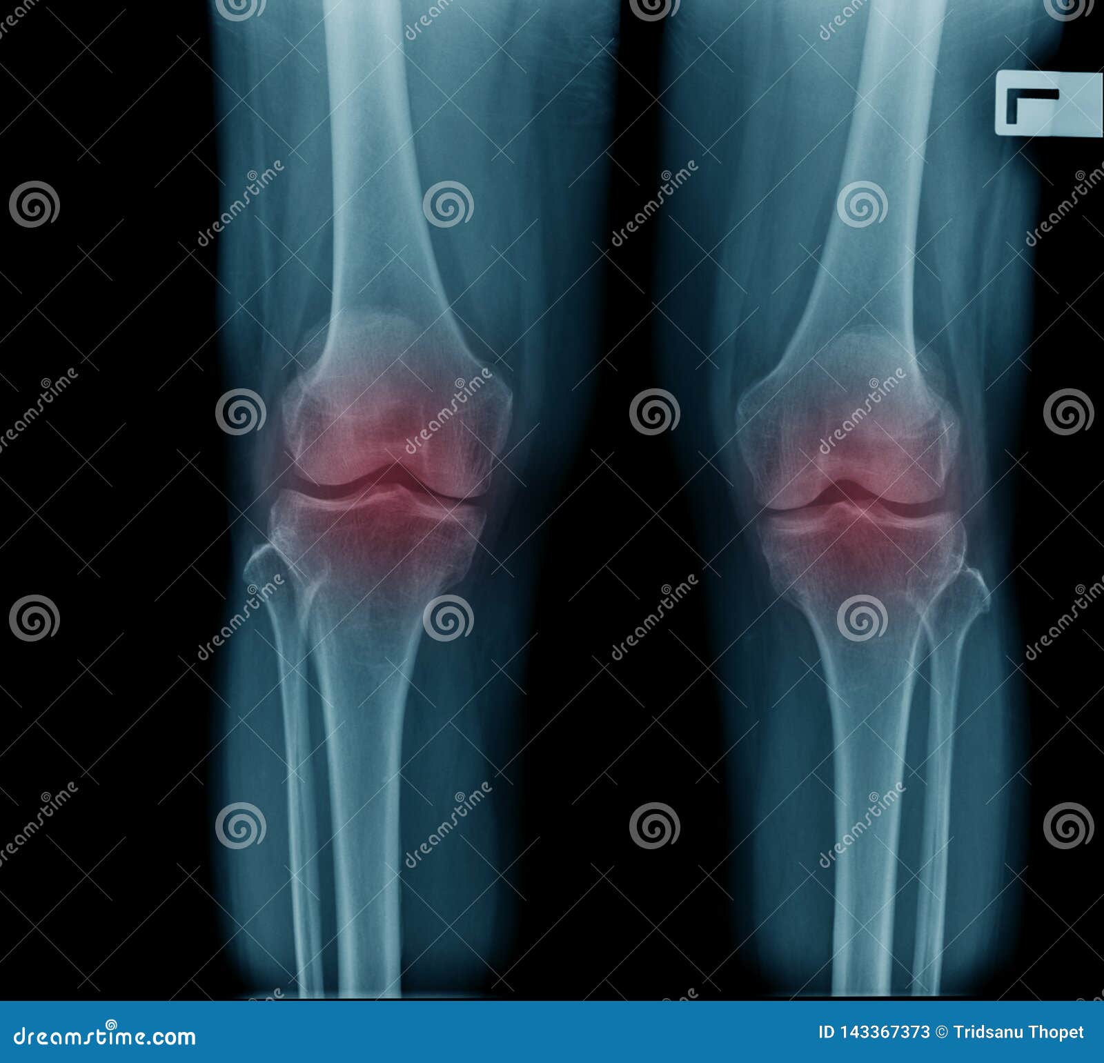 X-ray image of OA knee stock image. Image of care, narrow - 143367373