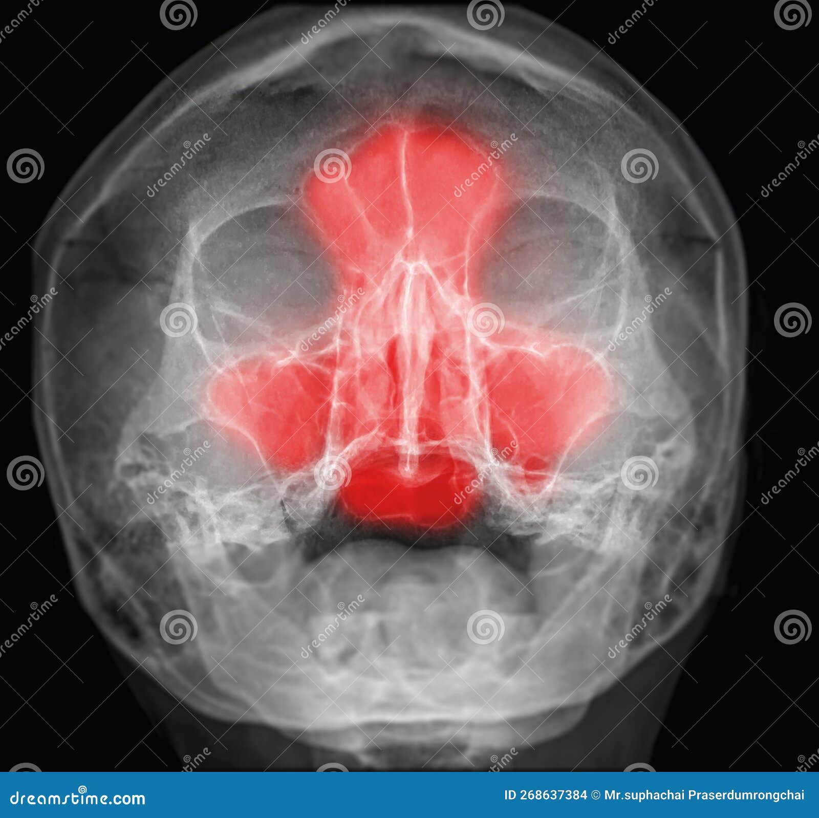 Acute Sinusitis X Ray