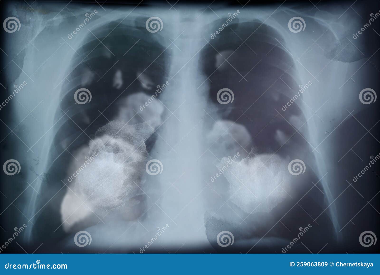 X-ray Image of Patient with Lung Cancer. Illustration Stock Image ...