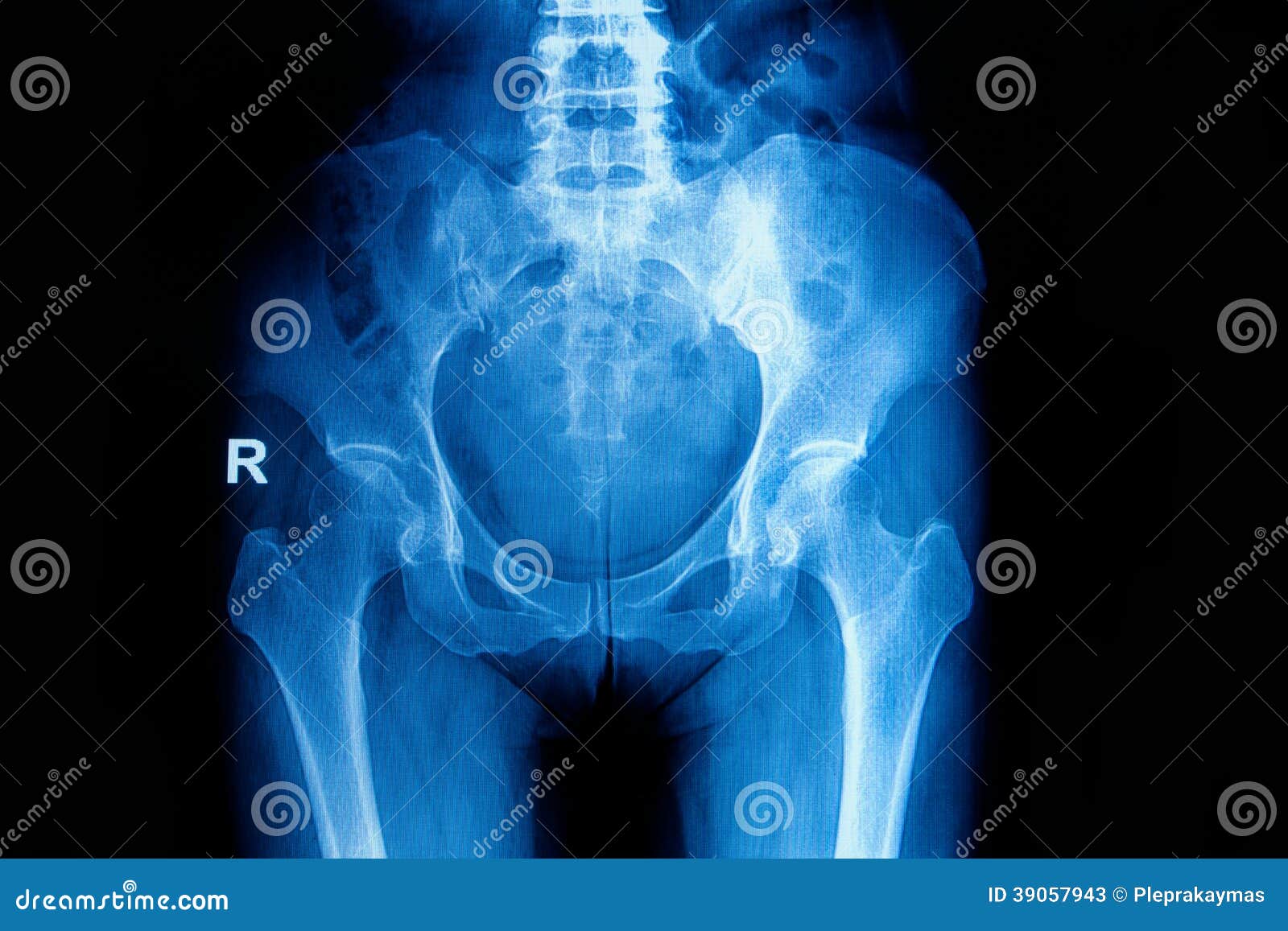 X-ray image pelvis and hip stock image. Image of medical - 39057943
