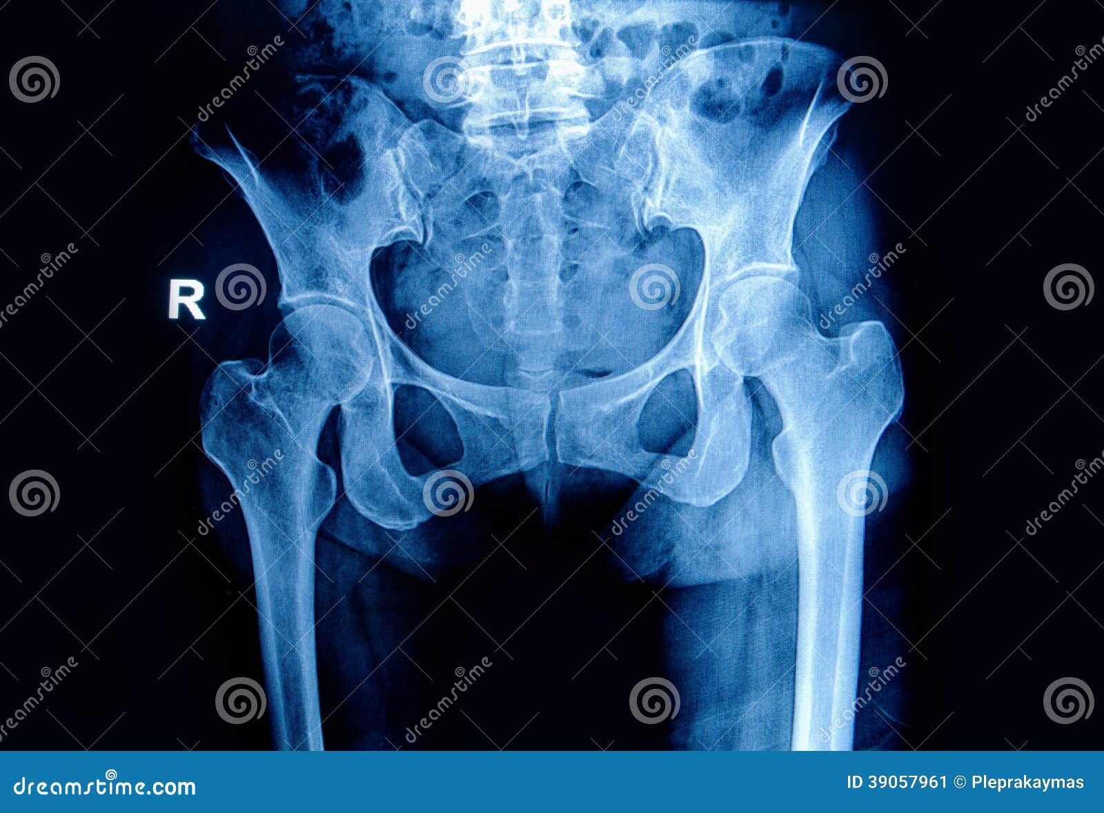 X-ray image pelvis and hip stock image. Image of lumbar - 39057961