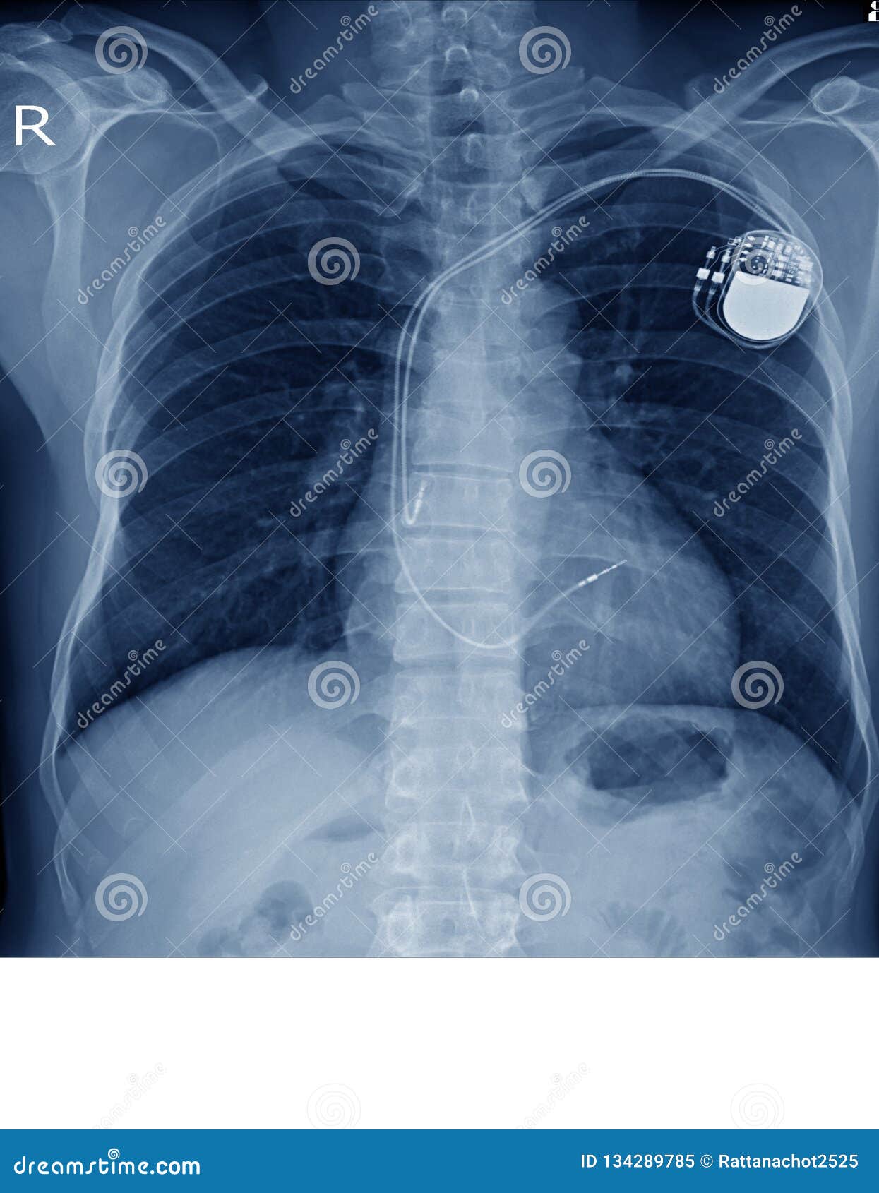 X-ray Image of Permanent Pacemaker Implant in Chest Body , Process in ...