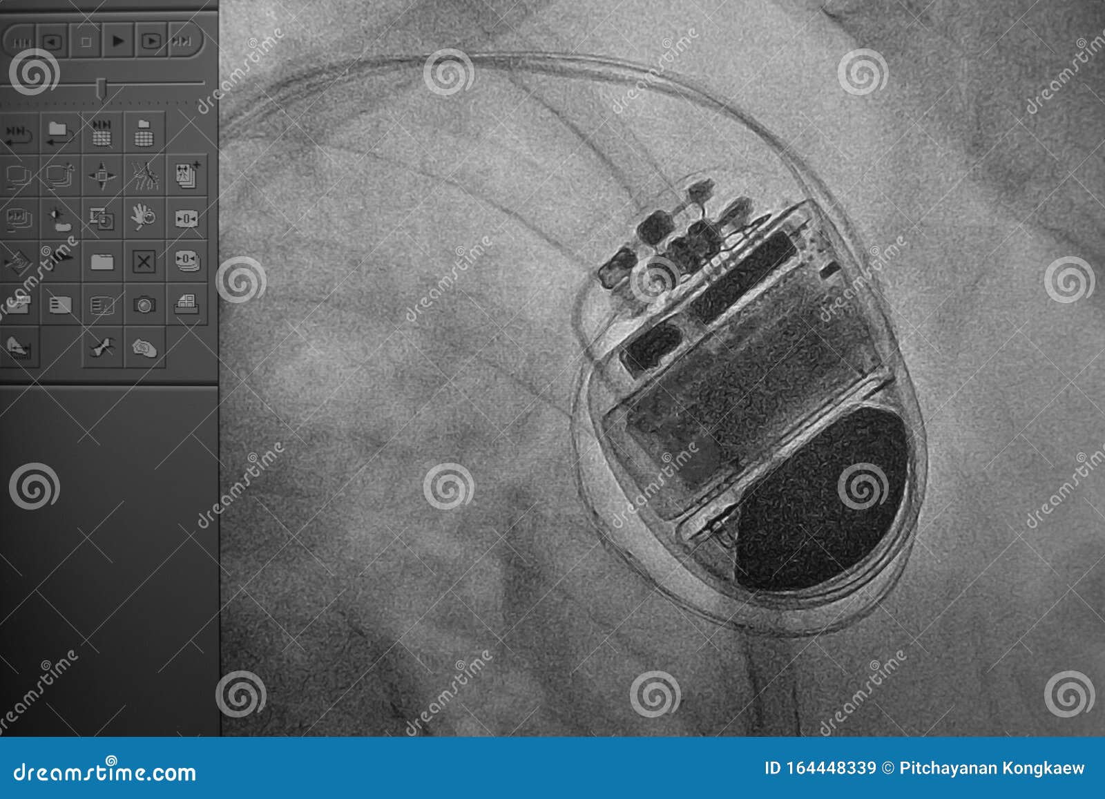 Permanent Pacemaker Implantation in Patient Editorial Stock Image ...