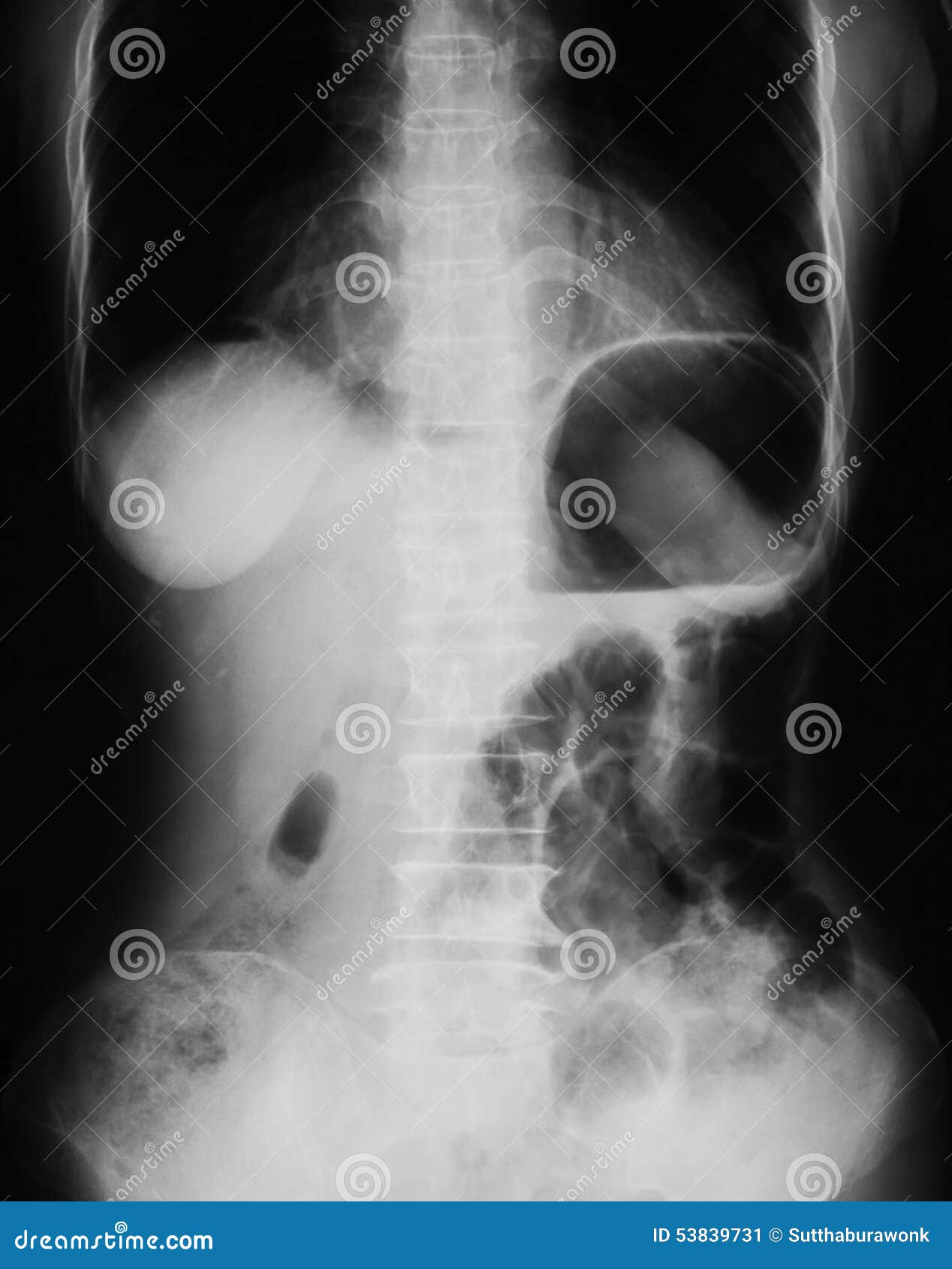X-ray Image of Plain Abdomen. Stock Image - Image of ileum, abdomen ...