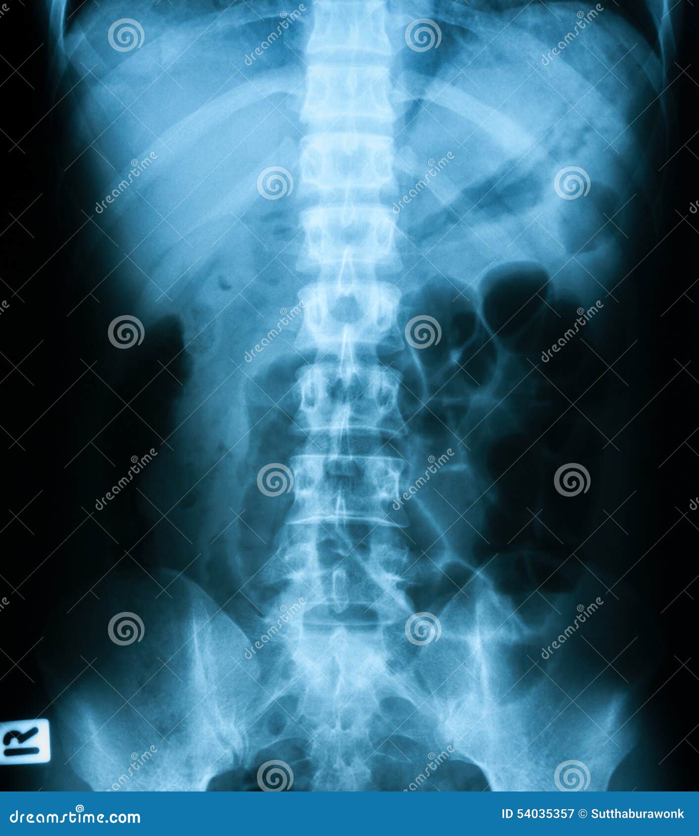 X-ray Image of Plain Abdomen. Stock Image - Image of bone, gastric ...