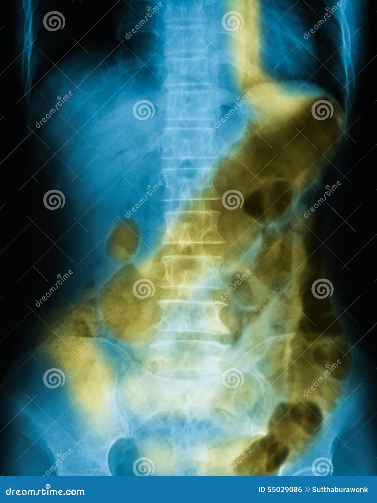 X-ray Image of Plain Abdomen Supine. Stock Photo - Image of cecum ...