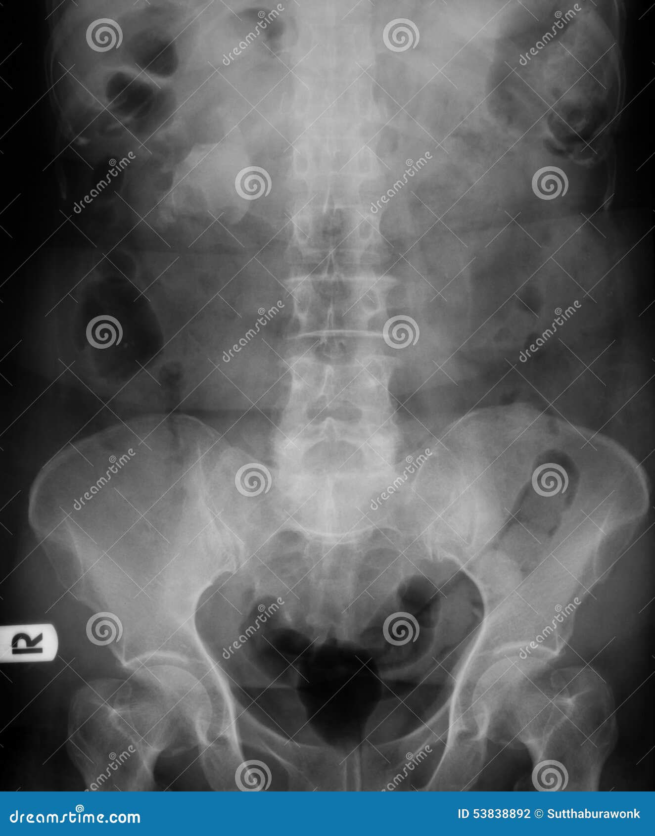 X-ray image of plain KUB. stock photo. Image of bladder - 53838892