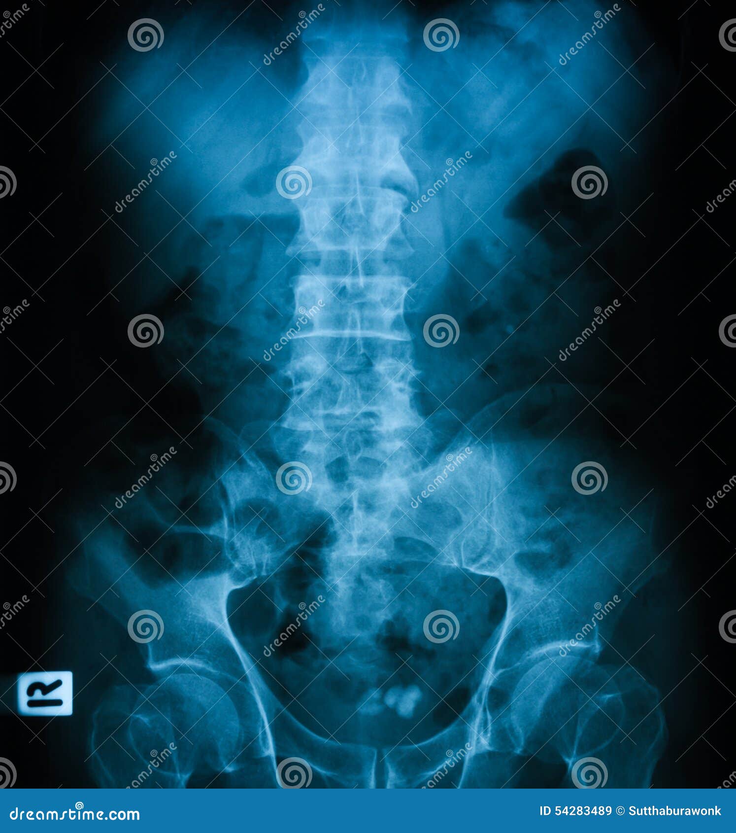 X-ray image of plain KUB. stock image. Image of inflammation - 54283489