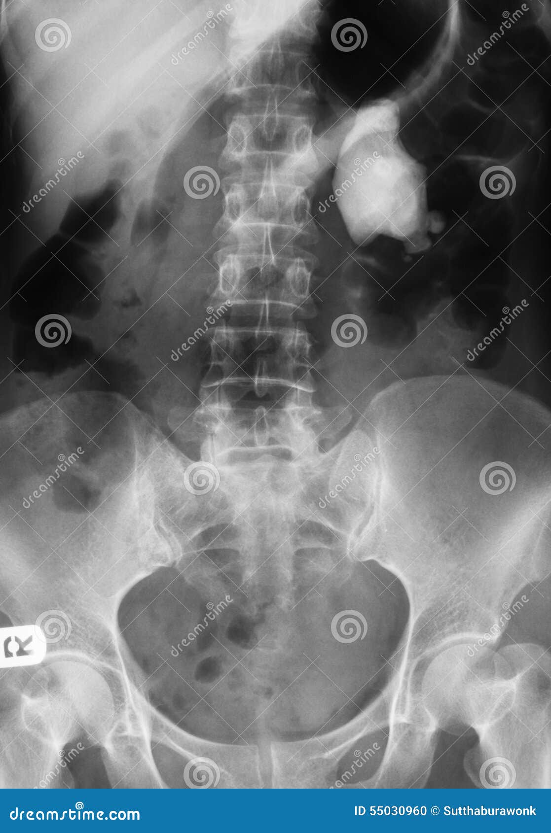 X-ray Image Of Plan KUB, Supine View. Stock Photo - Image: 55030960