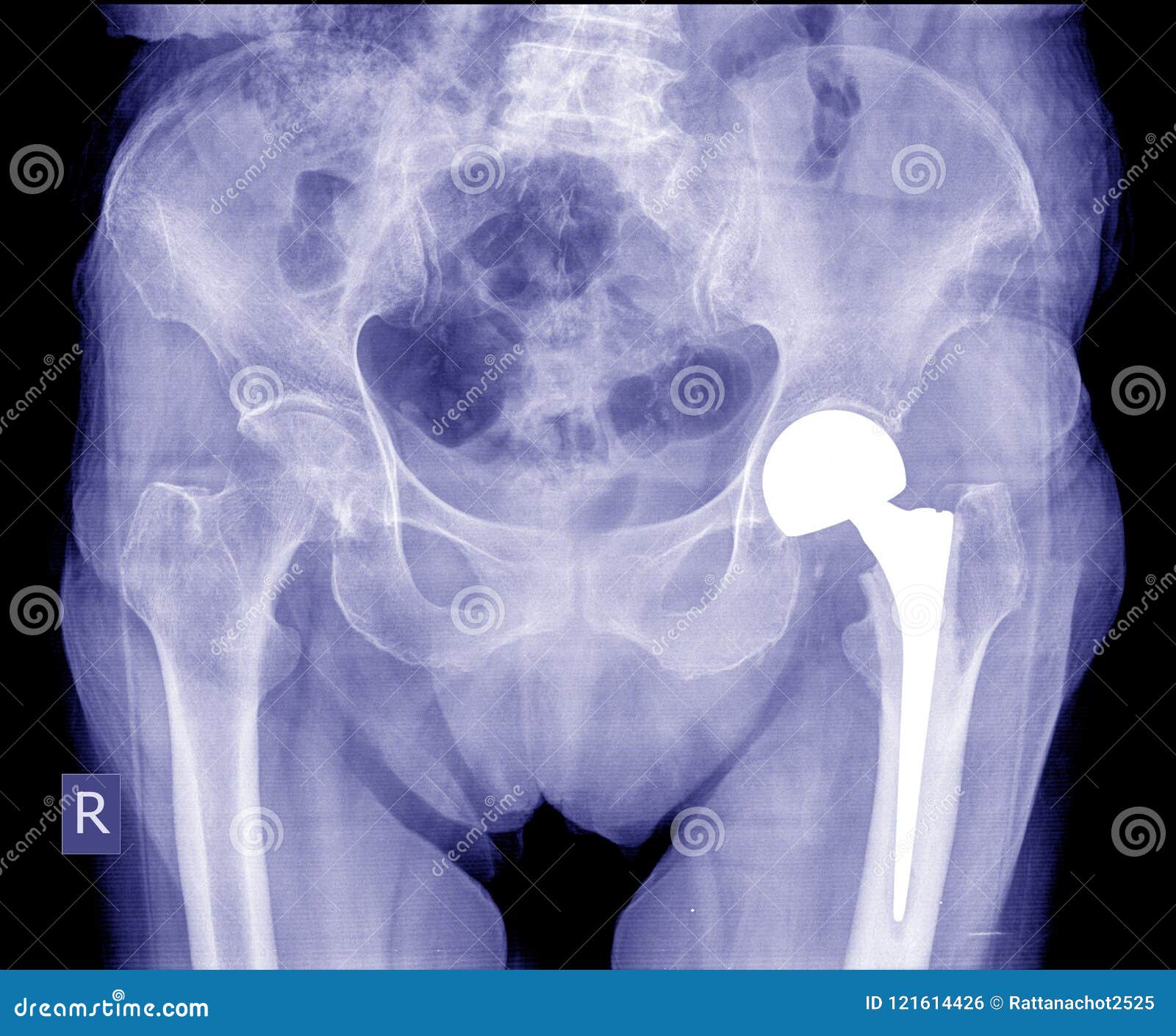 X-ray Image Post Operation Total Hip Replacement Stock Photo - Image of ...