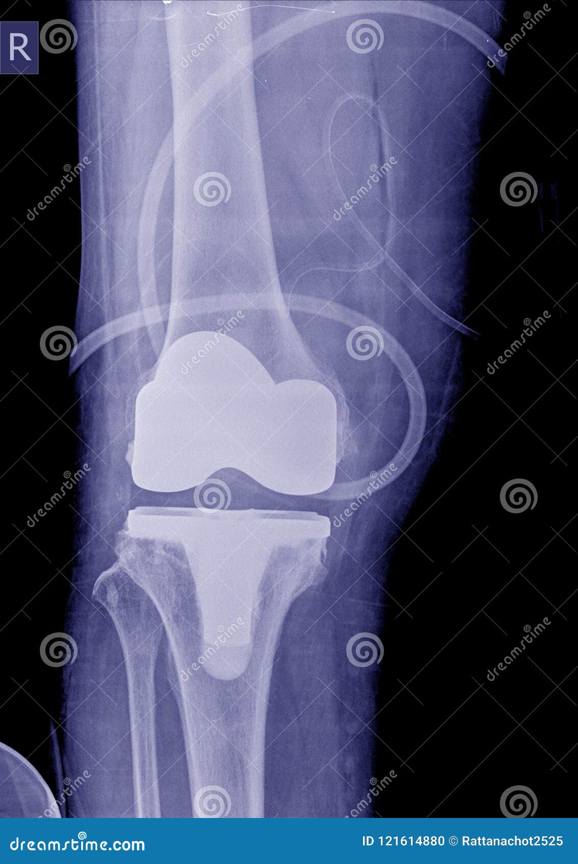 X-ray Image Post Operation Total Knee Replacement Stock Photo - Image ...