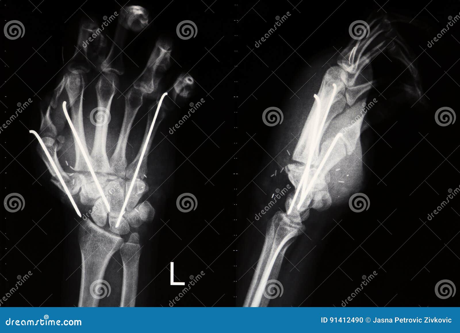 X-ray Image of Re-connected Hand Surgery Stock Photo - Image of care ...