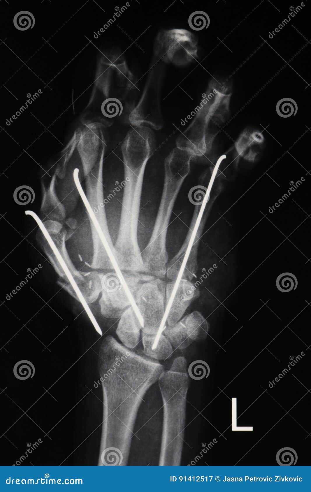 Hand Surgery Of A Dupuytren`s Disease, Contracture Or A Trigger Stock ...