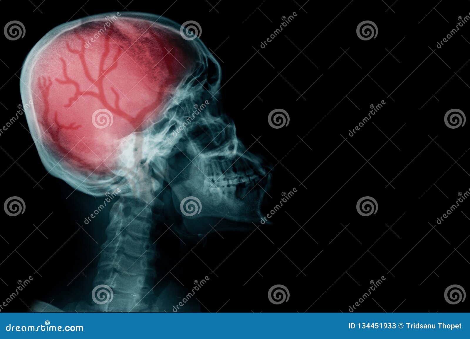 X-ray Image with Red Hight Light Stock Image - Image of disease ...