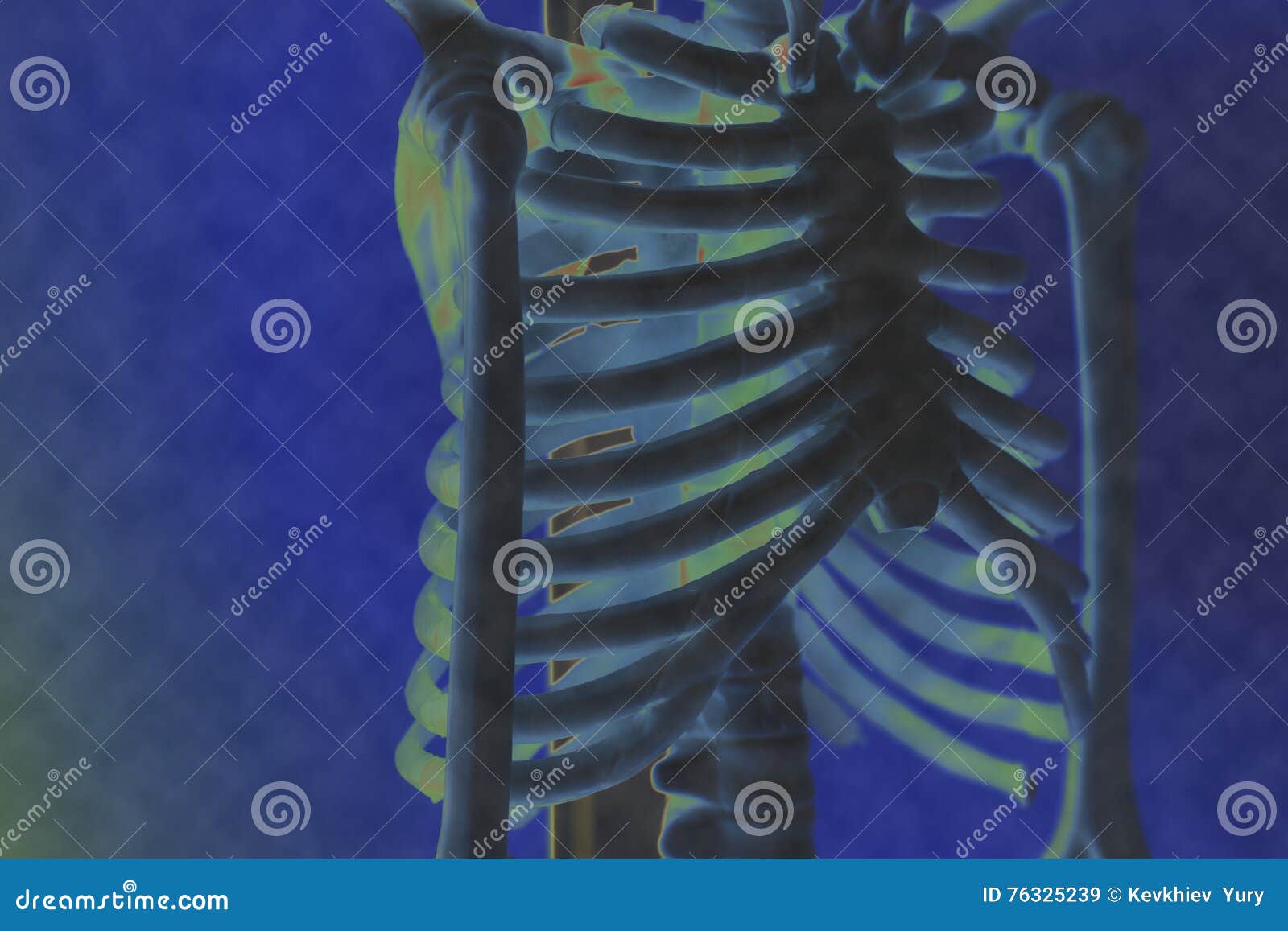 X-ray Image of the Rib of Man. Stock Image - Image of medical ...