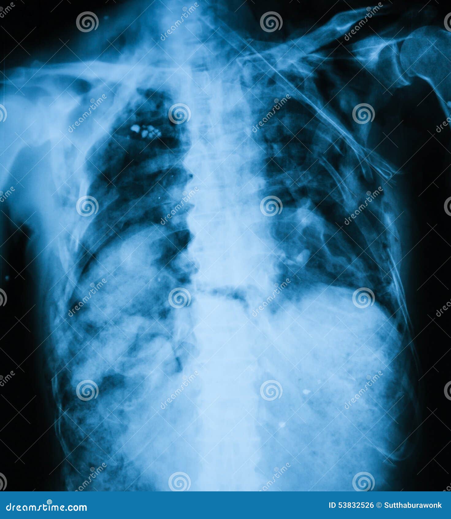 X-ray Image of Ribs, AP View. Stock Photo - Image of heart, abdomen ...