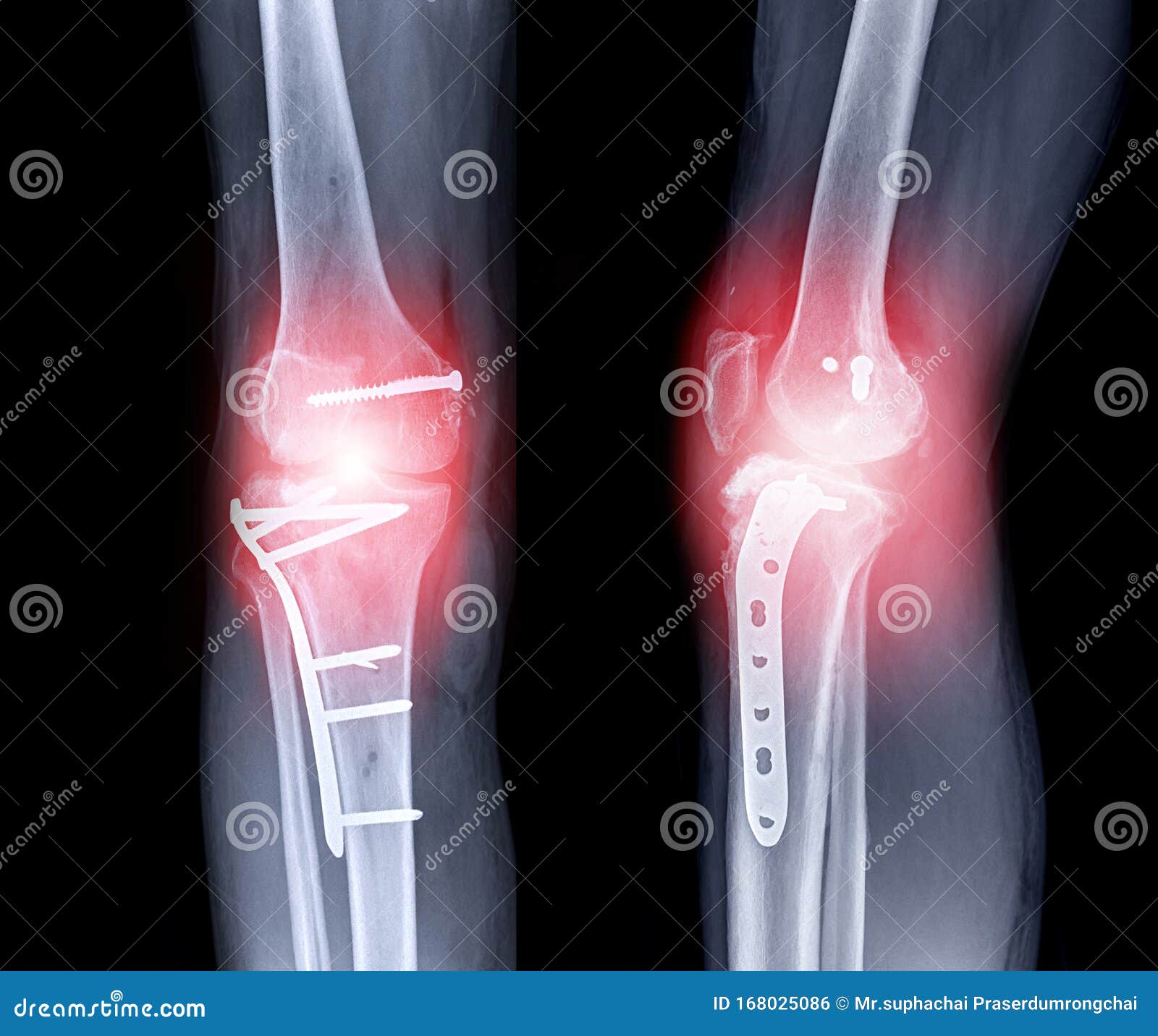 X-ray Image of Right Knee AP View Stock Photo - Image of joint, illness ... X-ray Image of Right Knee AP View Stock Photo - Image of joint, illness ...