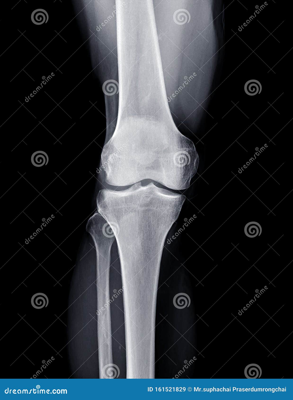 X-ray Image of Right Knee Joint AP View. Stock Image - Image of health ...