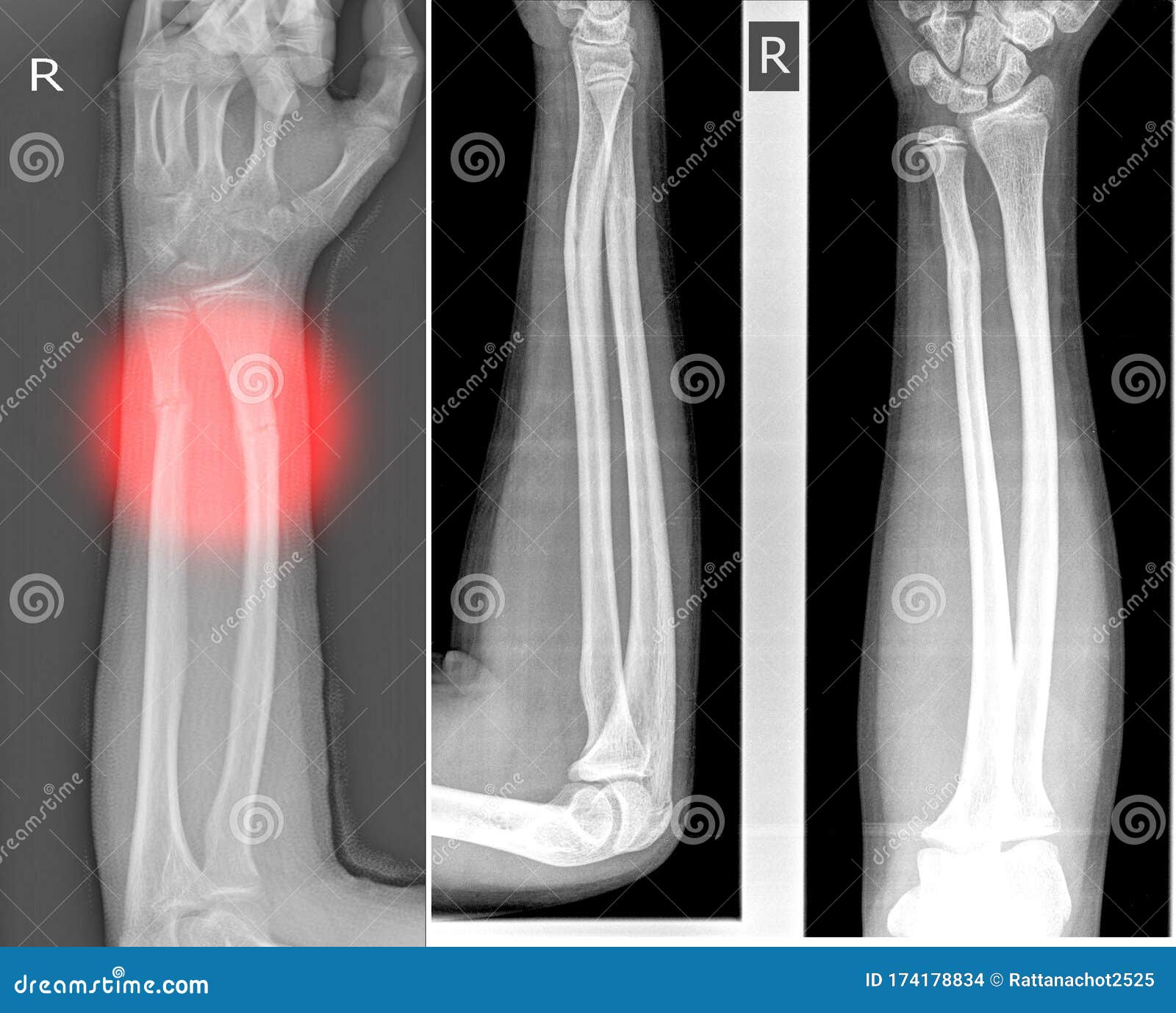 Right Distal Radius Fracture